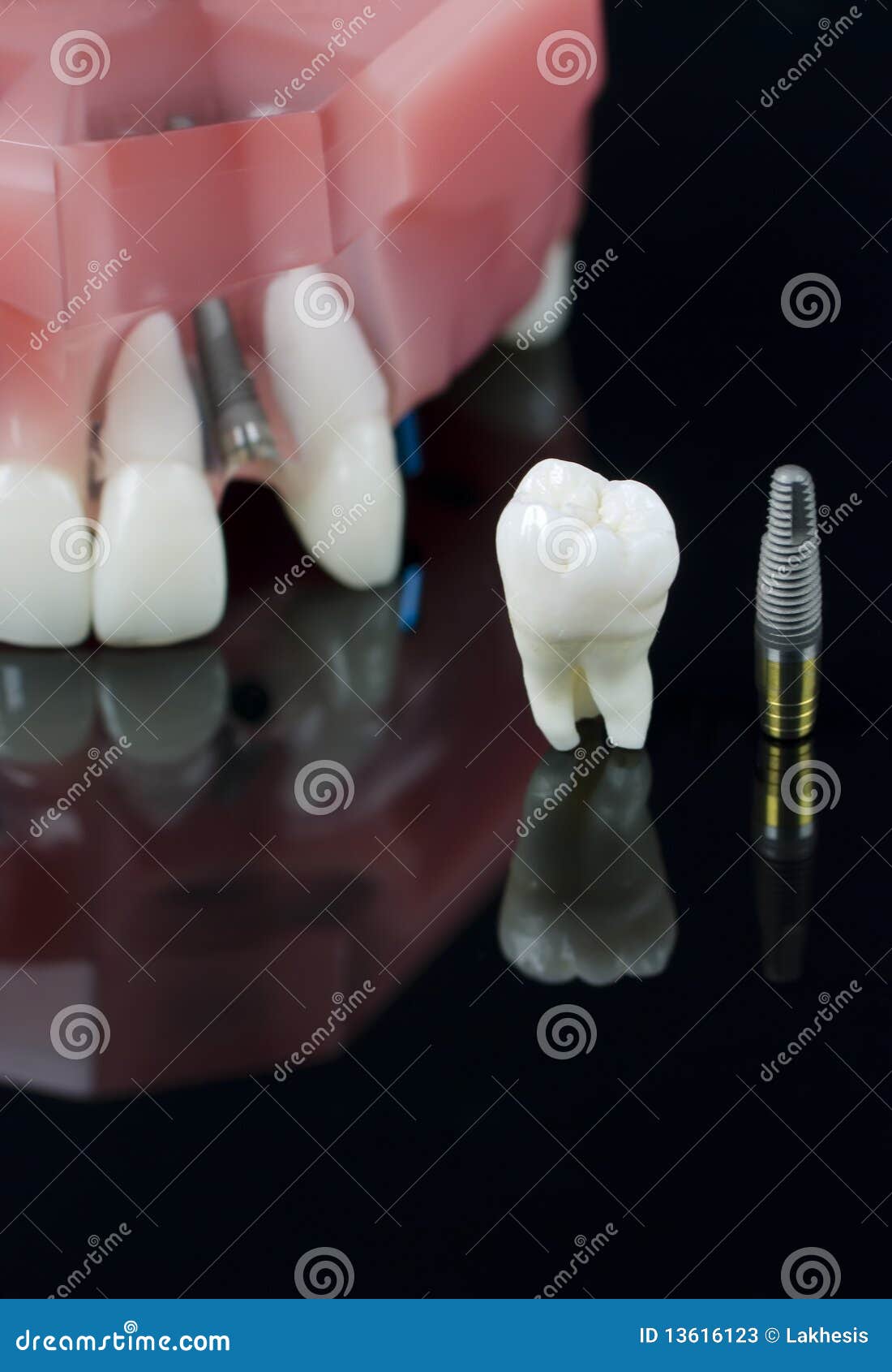Wisdom Tooth, Implant and Teeth Model. Stock Image - Image of ...
