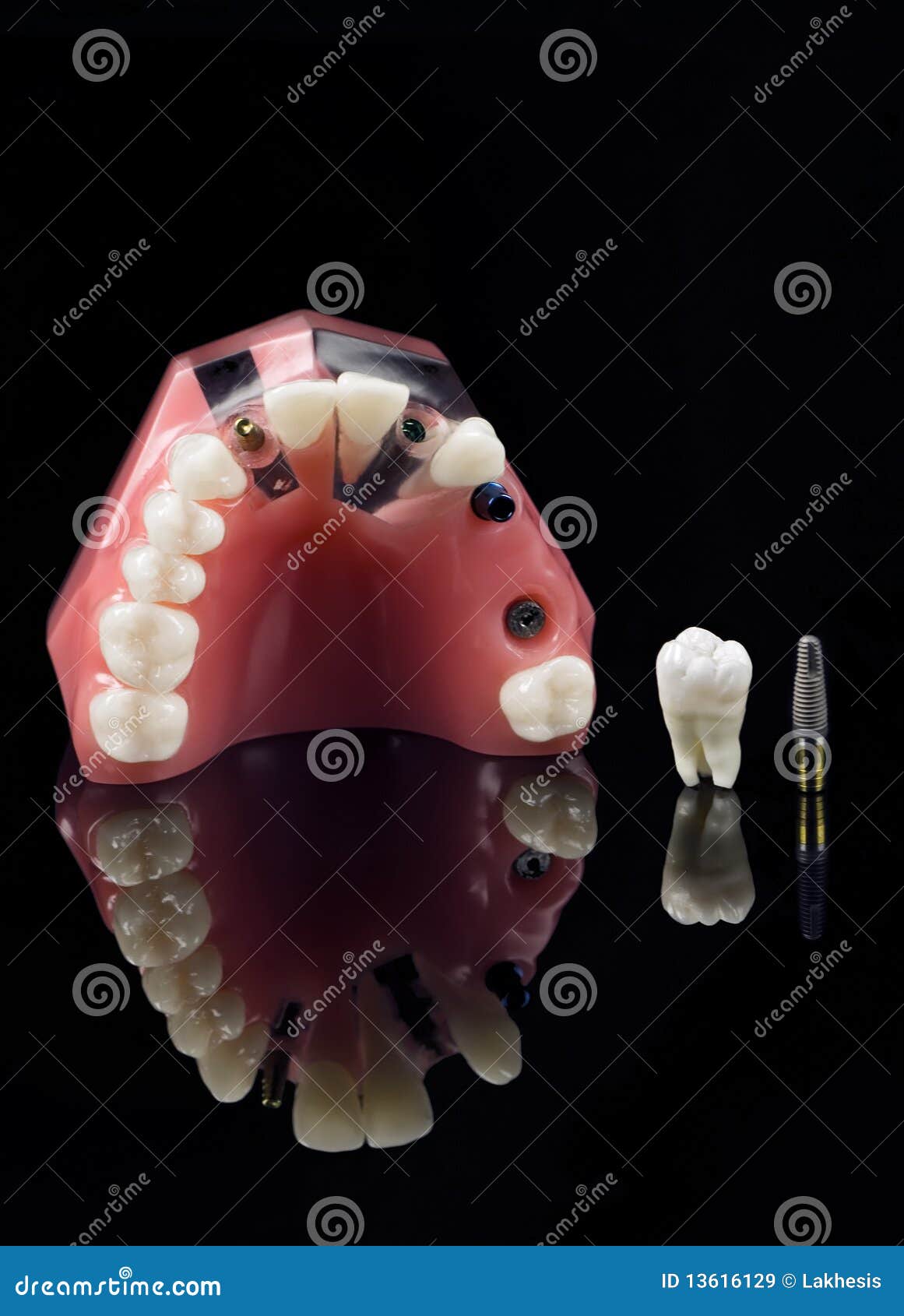 Wisdom Tooth, Implant and Teeth Model Stock Image - Image of ...