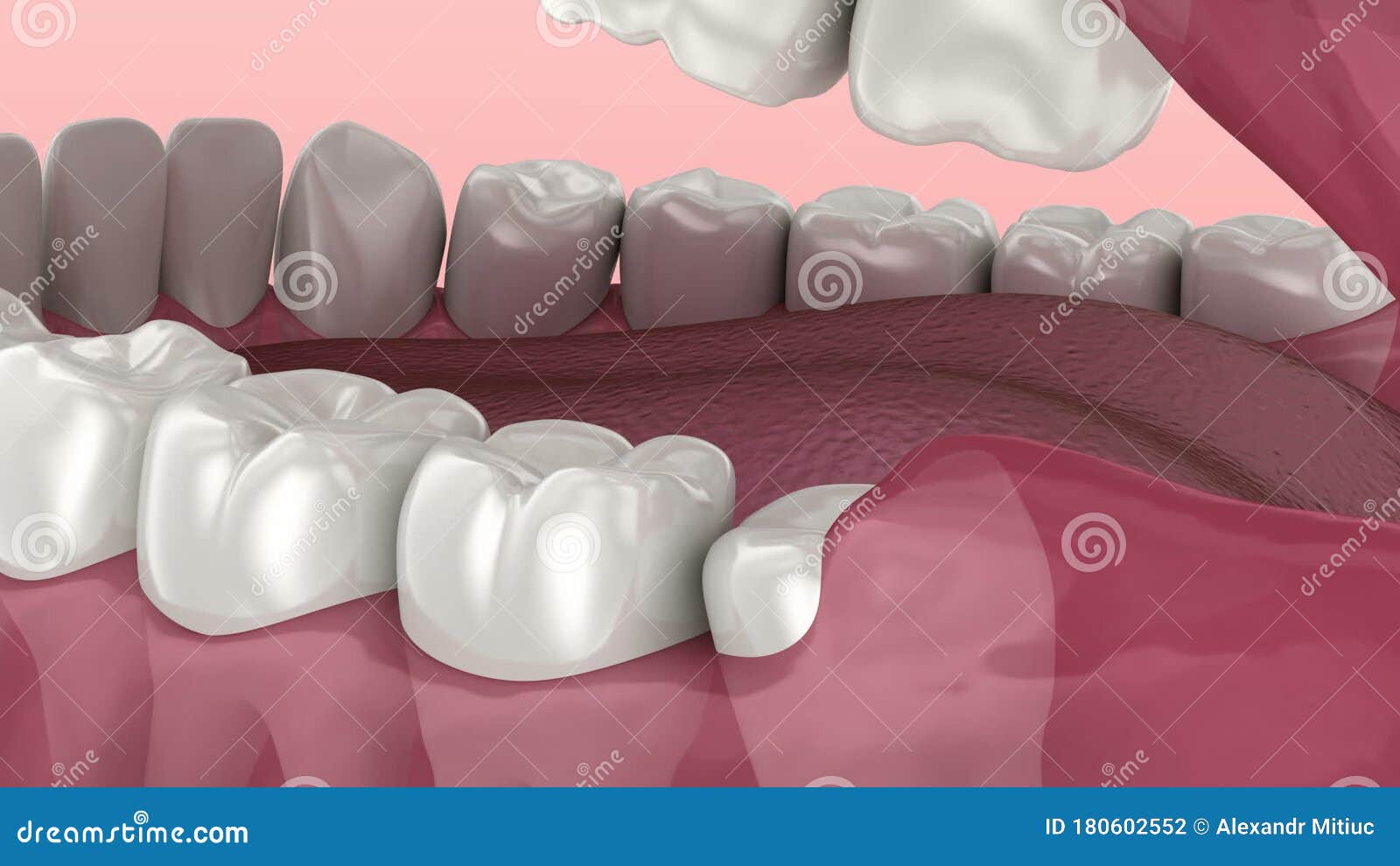 Wisdom Tooth Problem. Medically Accurate Tooth 3D Animation Stock ...