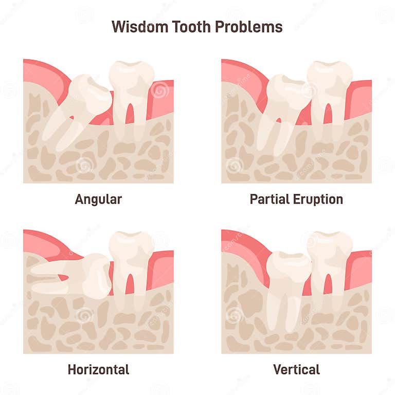 Wisdom Tooth Problems Set. Impaction, Wisdom Teeth Growing with Wrong ...
