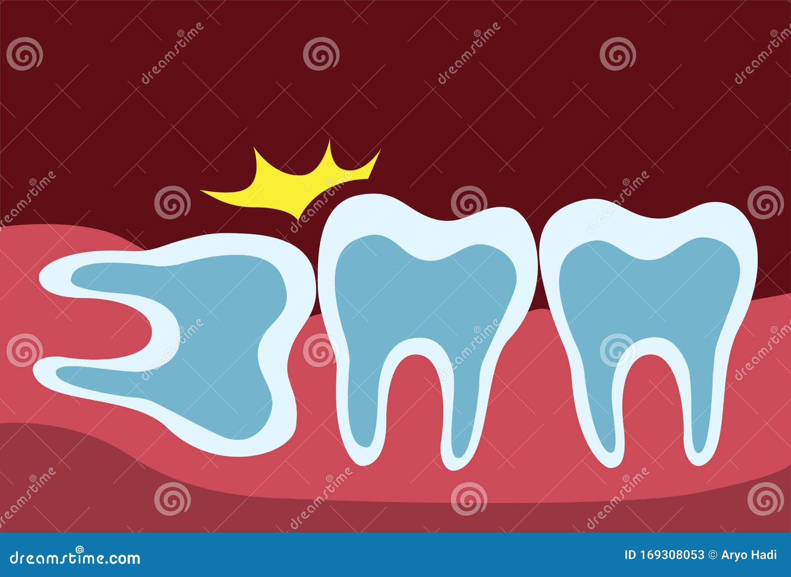 Wisdom Tooth Pushing Adjacent Teeth, Wisdom Tooth Problem. Teeth Row ...