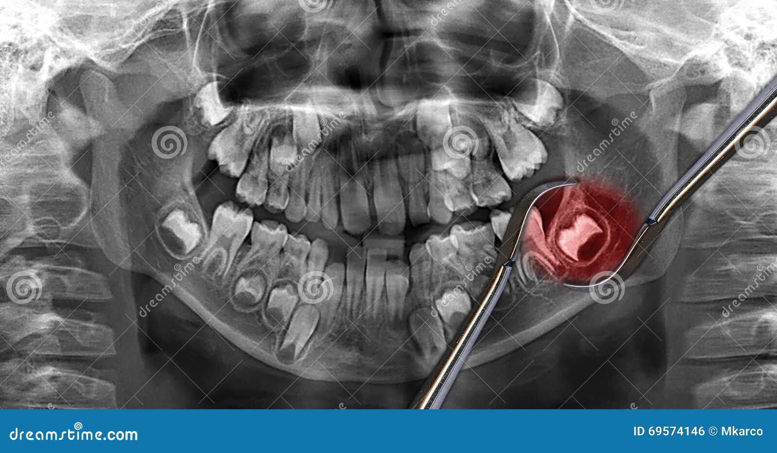 Wisdom Tooth, X-ray Dental Scan Stock Photo - Image of radiology ...