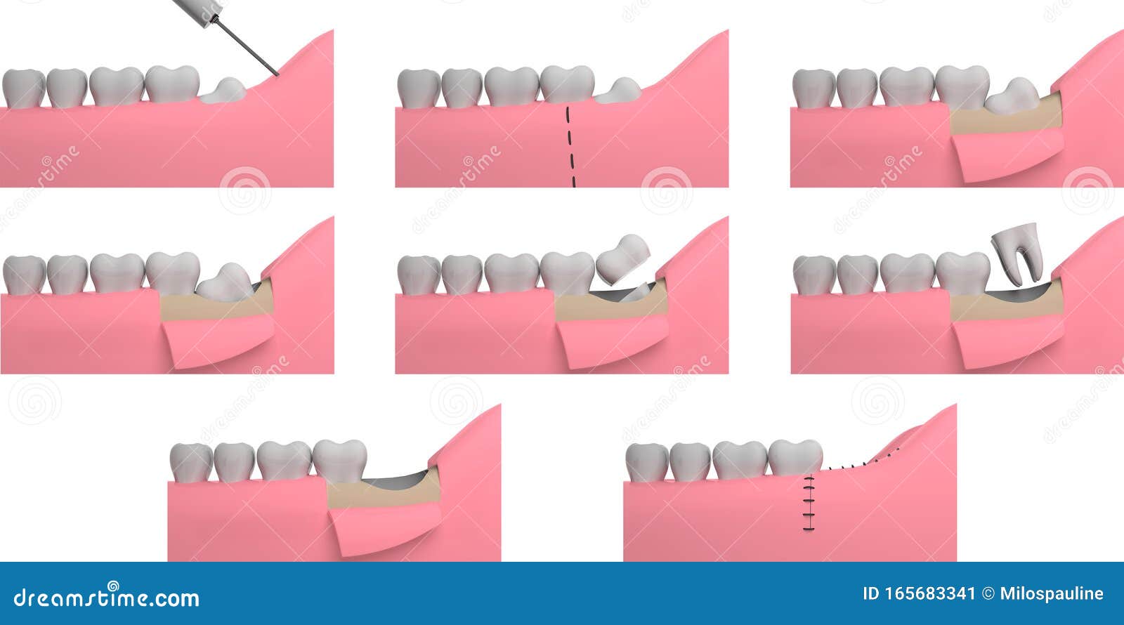 Wisdom Tooth Removing, Collage, 3D-rendering, White Background Stock ...