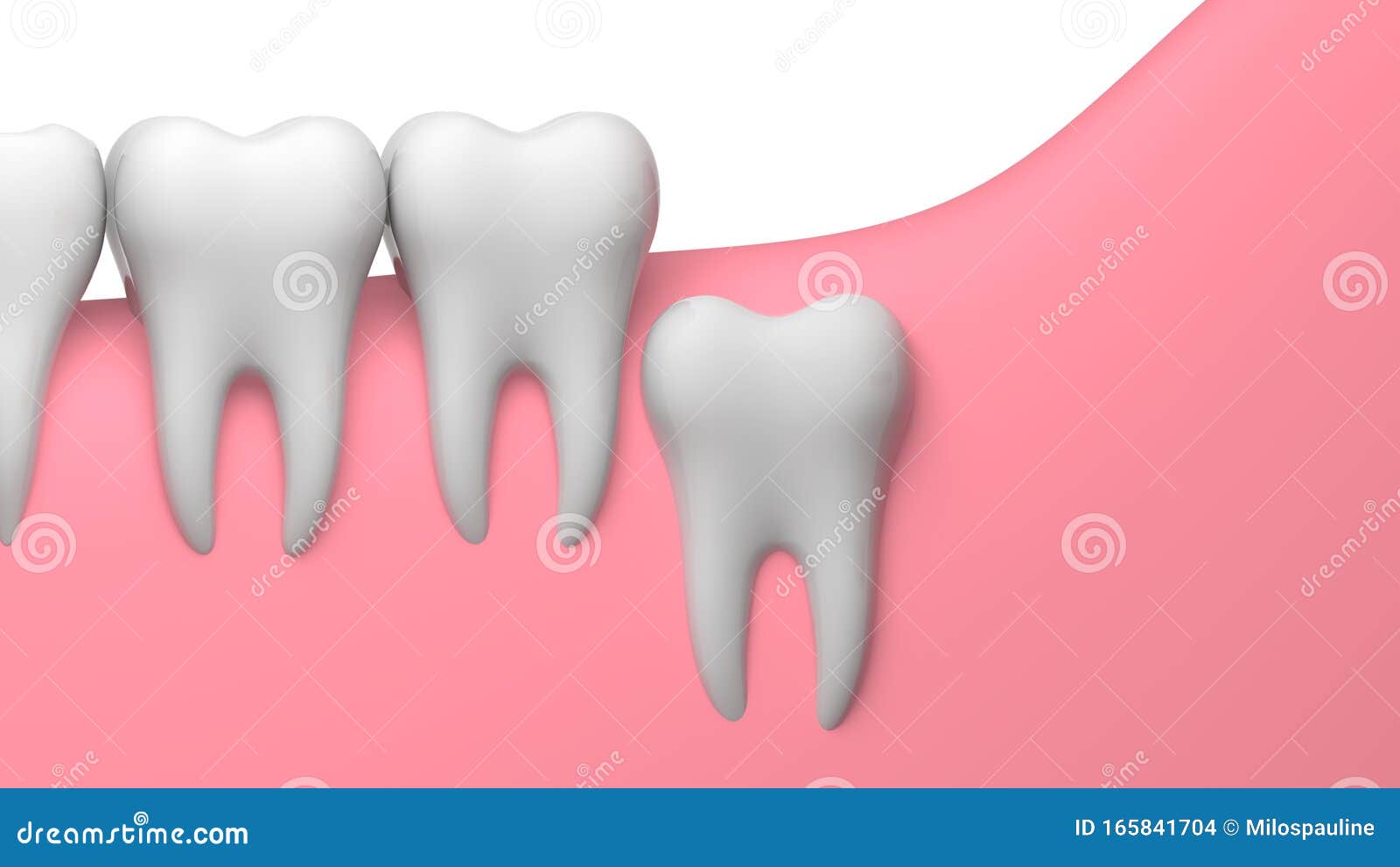Vertical Impaction Of Wisdom Tooth. Medically Accurate Tooth 3D ...