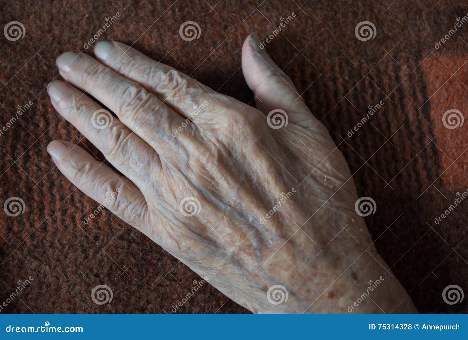 The Withered Hand of a Patient Lying on a Background of Old Blanket ...