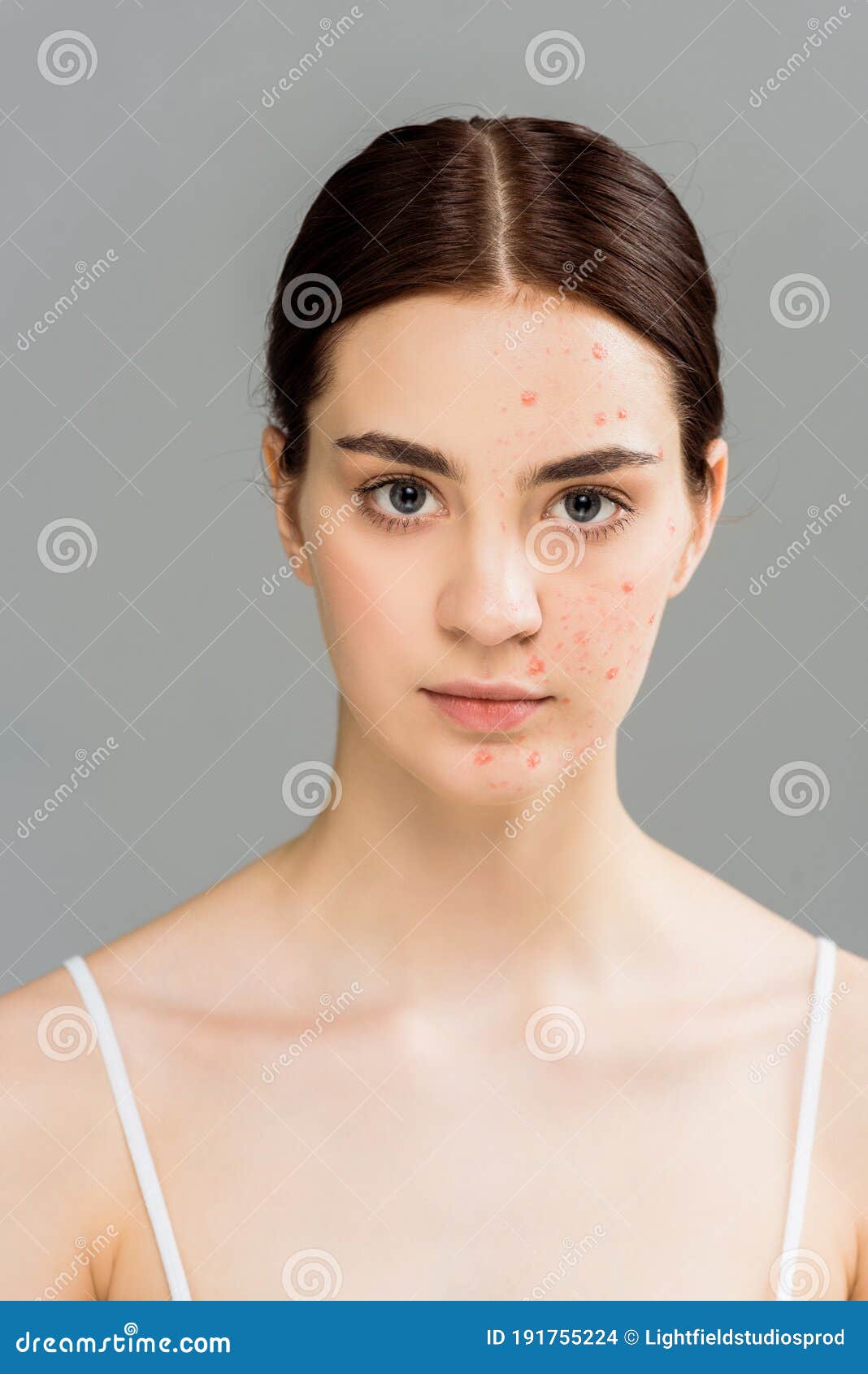 Woman with Acne on Face Looking at Camera Stock Photo - Image of pretty ...
