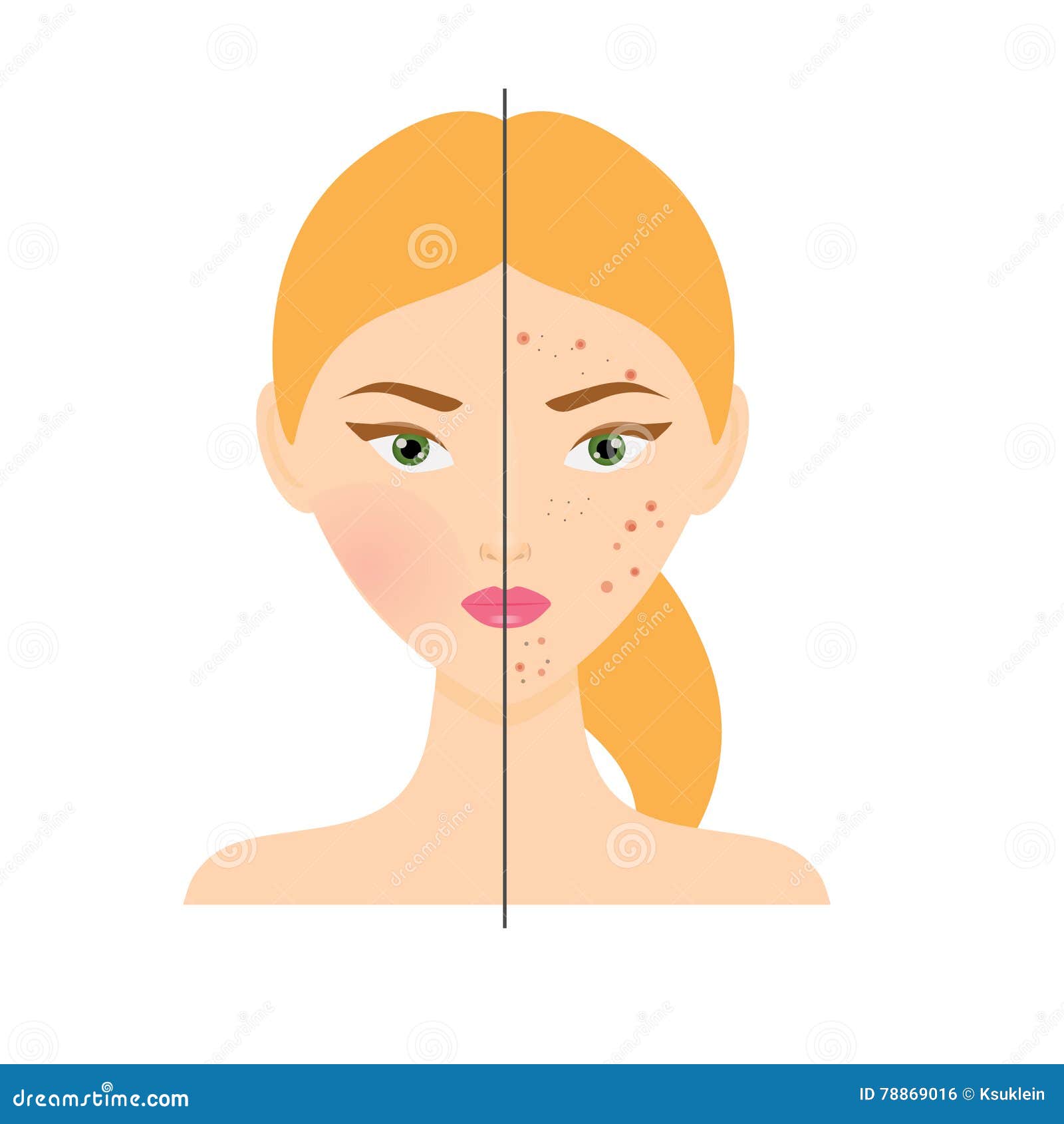 Woman With Acne Skin Problem And Healthy Skin Vector Illustration