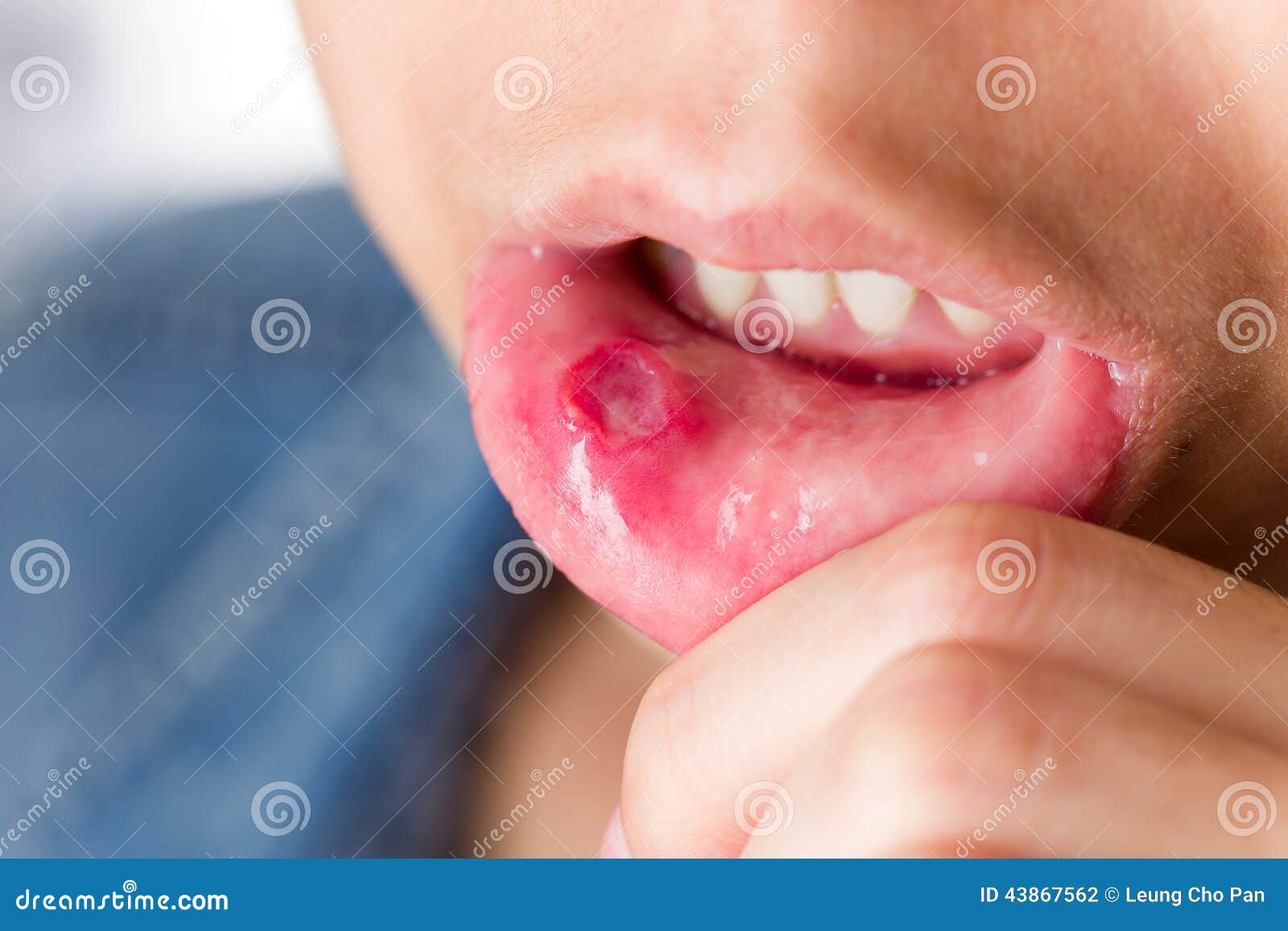 Woman with aphtha stock photo. Image of pain, aphthous - 43867562