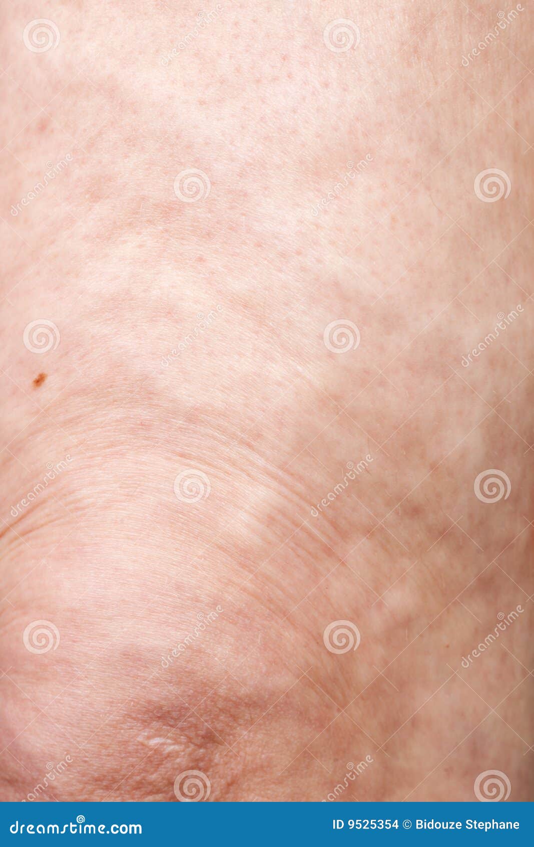 Woman Cellulite Stock Images - Image: 9525354