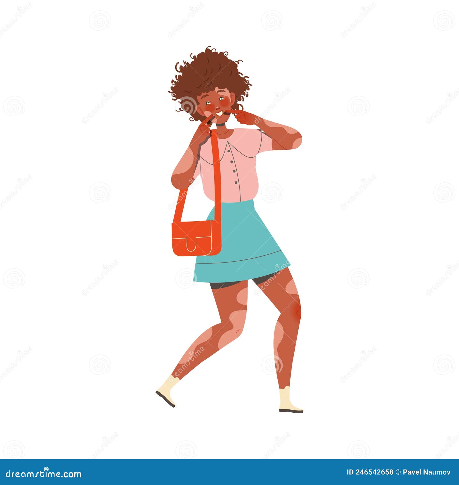 Character With Vitiligo Vector Icon, Pigmentation Skin On Different ... Character With Vitiligo Vector Icon, Pigmentation Skin On Different ...