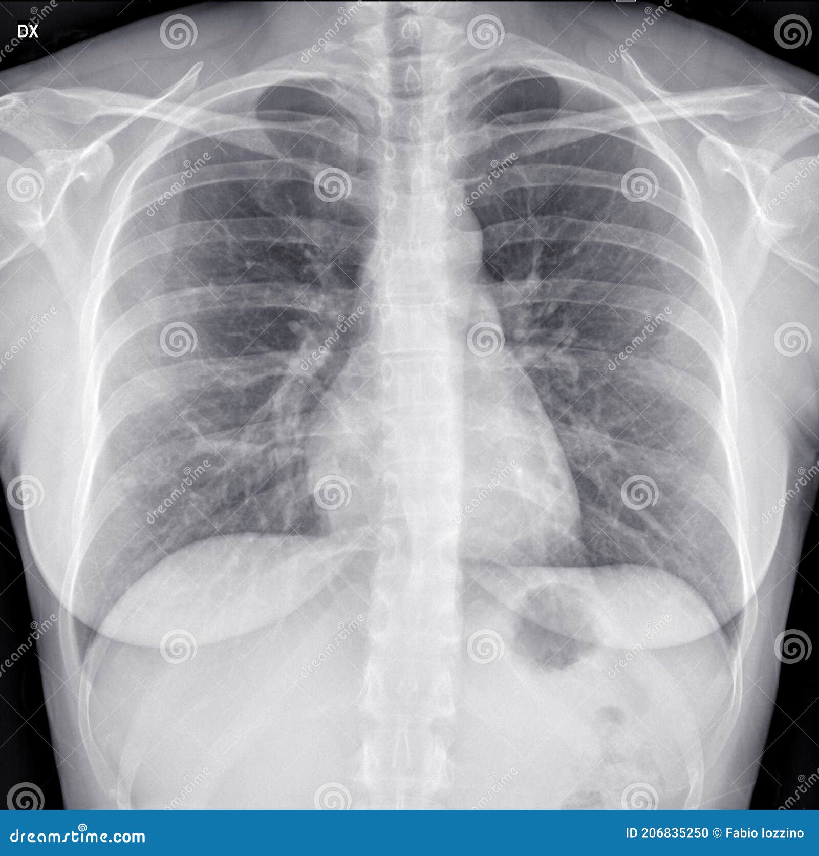 Woman Chest X-ray. Frontal View Stock Photo - Image of examination ...