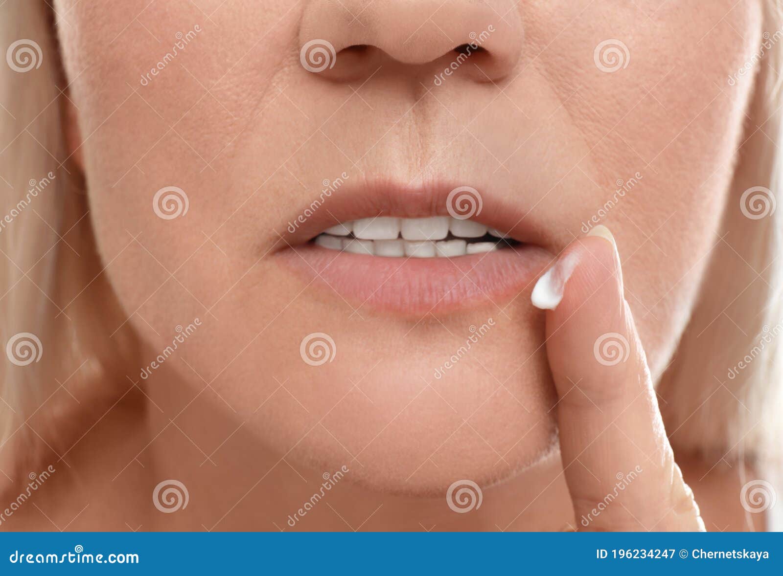 Woman with Cold Sore Applying Cream on Lips, Closeup Stock Image ...