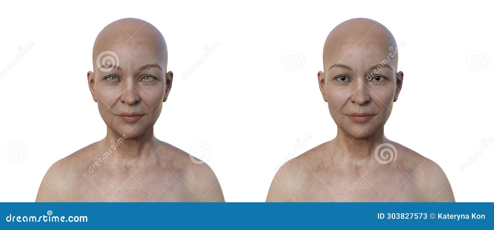 A Woman With Dilated And Constricted Eye Pupils, Illustration Royalty ...