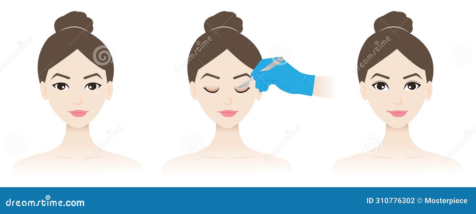 The Woman With Double Eyelid Surgery Before And After Vector ...