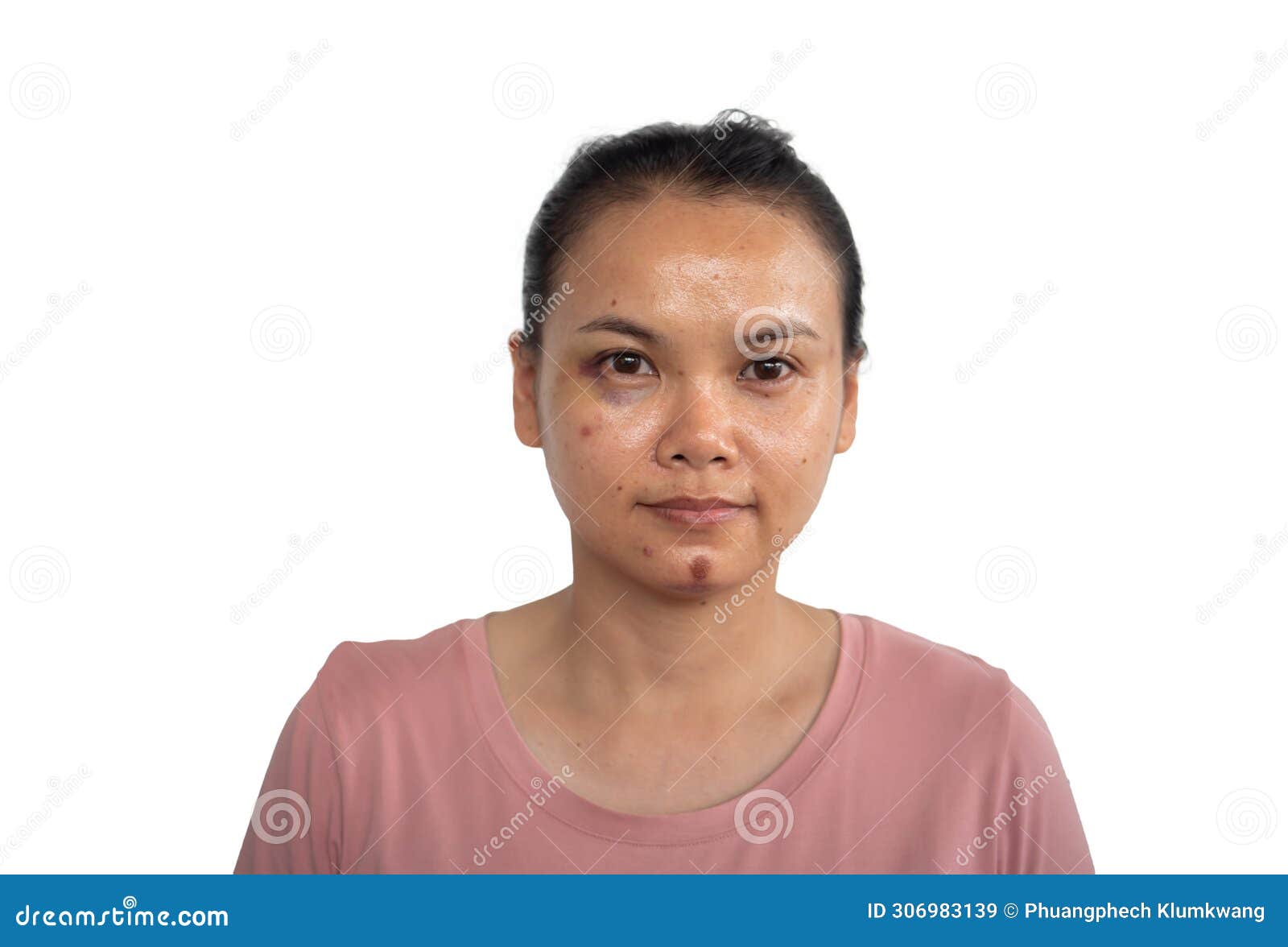 Woman Face Bruised Due To Surgery Stock Image - Image of cosmetologist ...