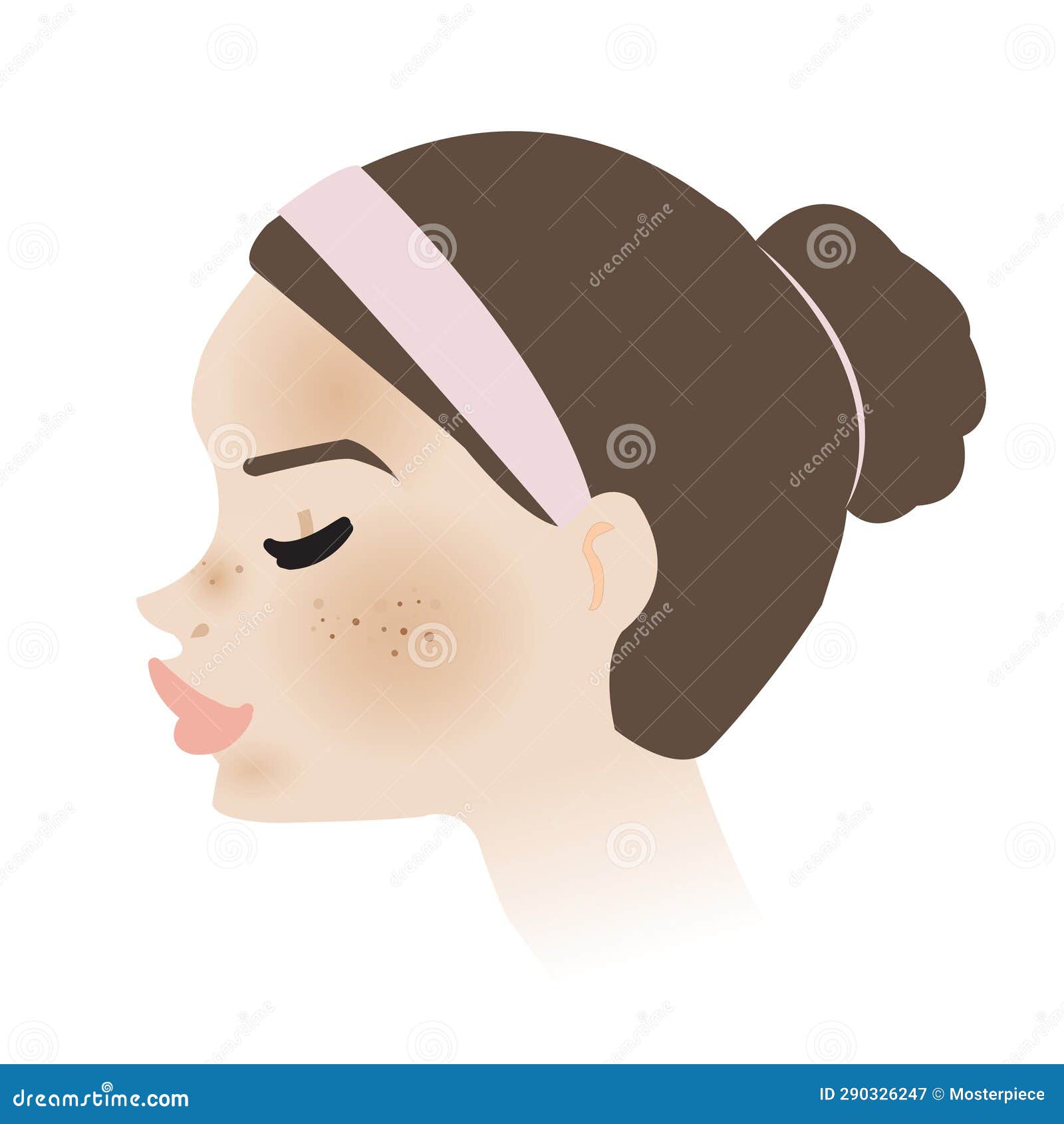 Woman With Melasma On Her Face. Illustration Of Person With Dark Spots ...