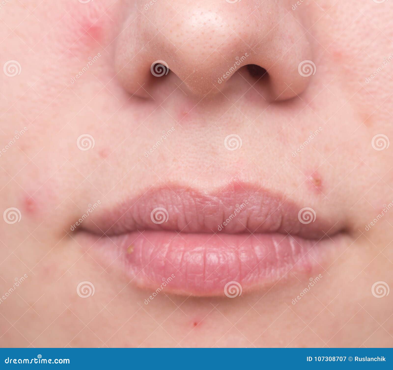 Problematic woman skin stock image. Image of young, nose - 107308707