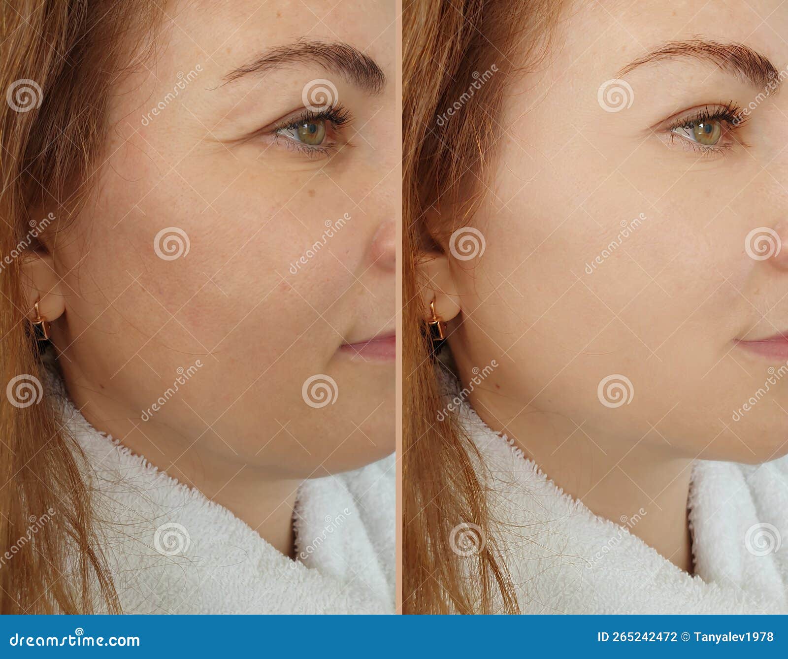 Woman Face Wrinkle before and after Treatment Stock Photo - Image of ...