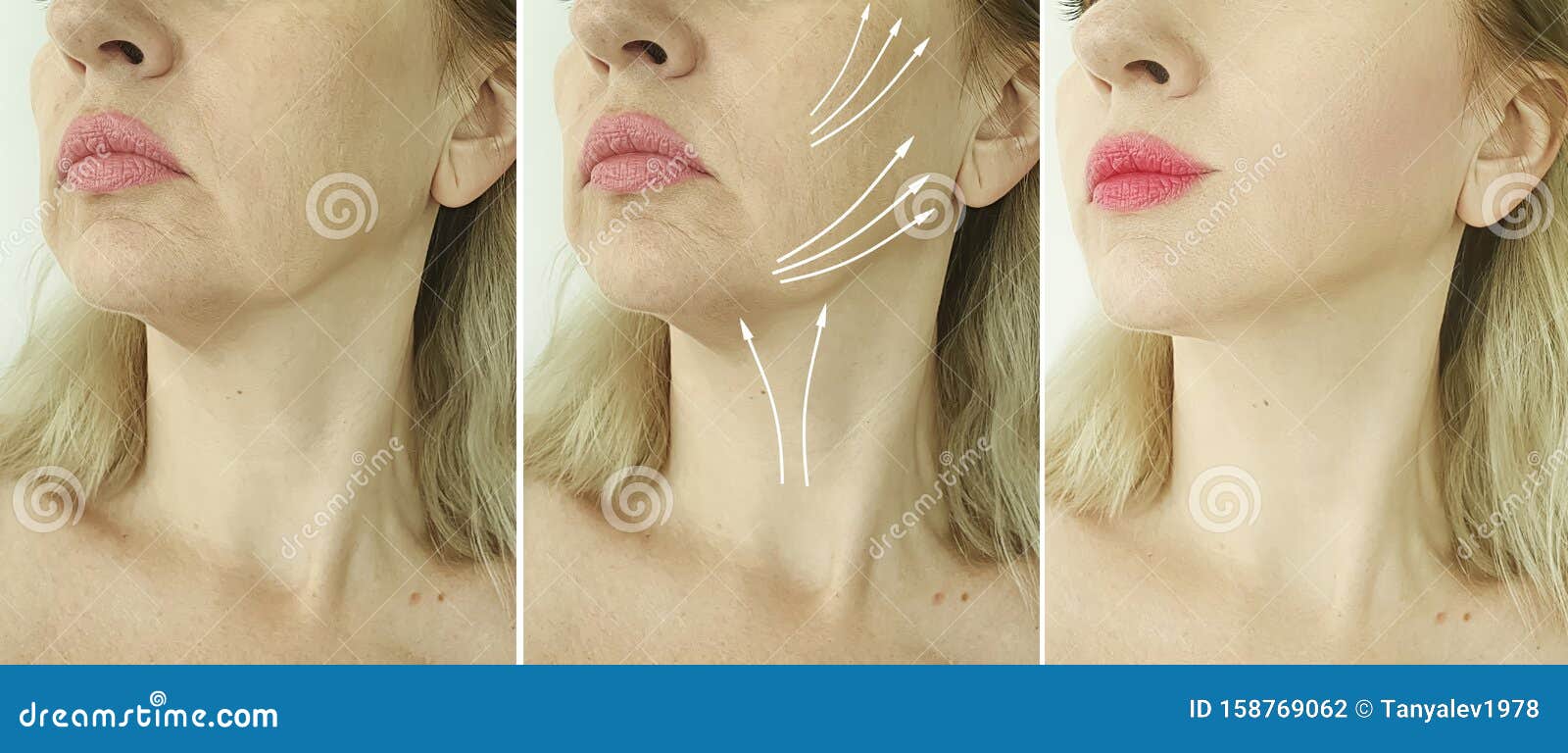 Woman Face Wrinkles Removal before and after Thread Effect Lifting ... Woman Face Wrinkles Removal before and after Thread Effect Lifting ...