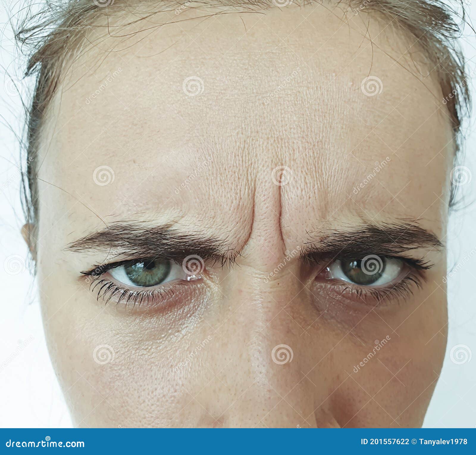 Woman Face Wrinkles Treatment Forehead Stock Photo - Image of filler ...
