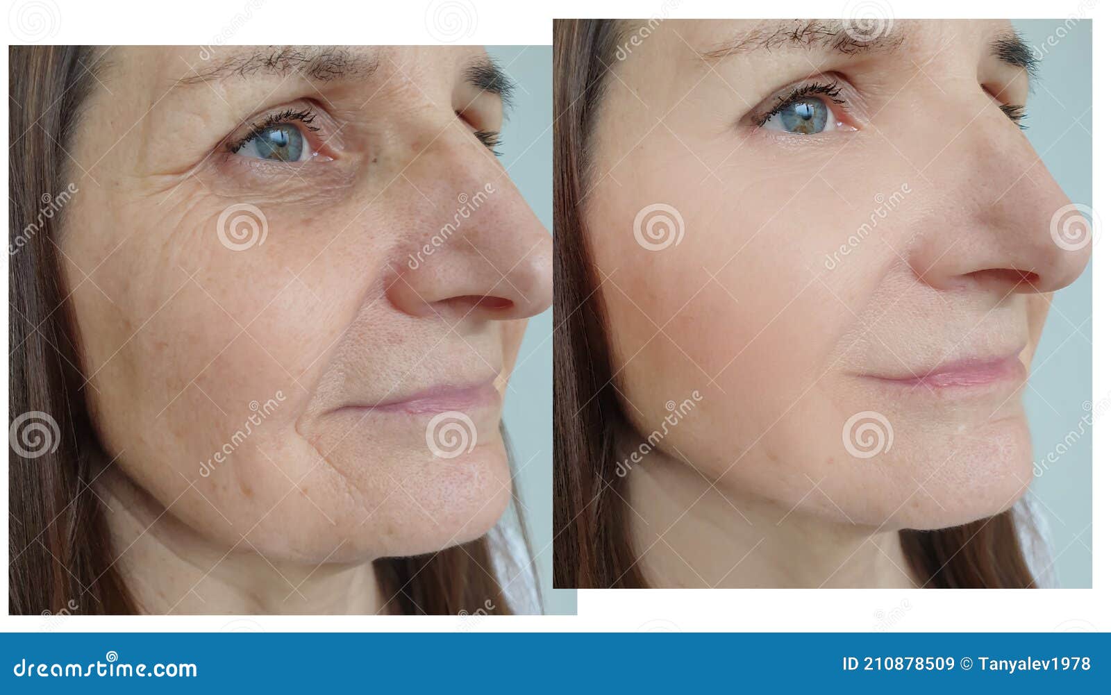 Woman Face Wrinkles before and after Sagging Treatment Stock Image ...
