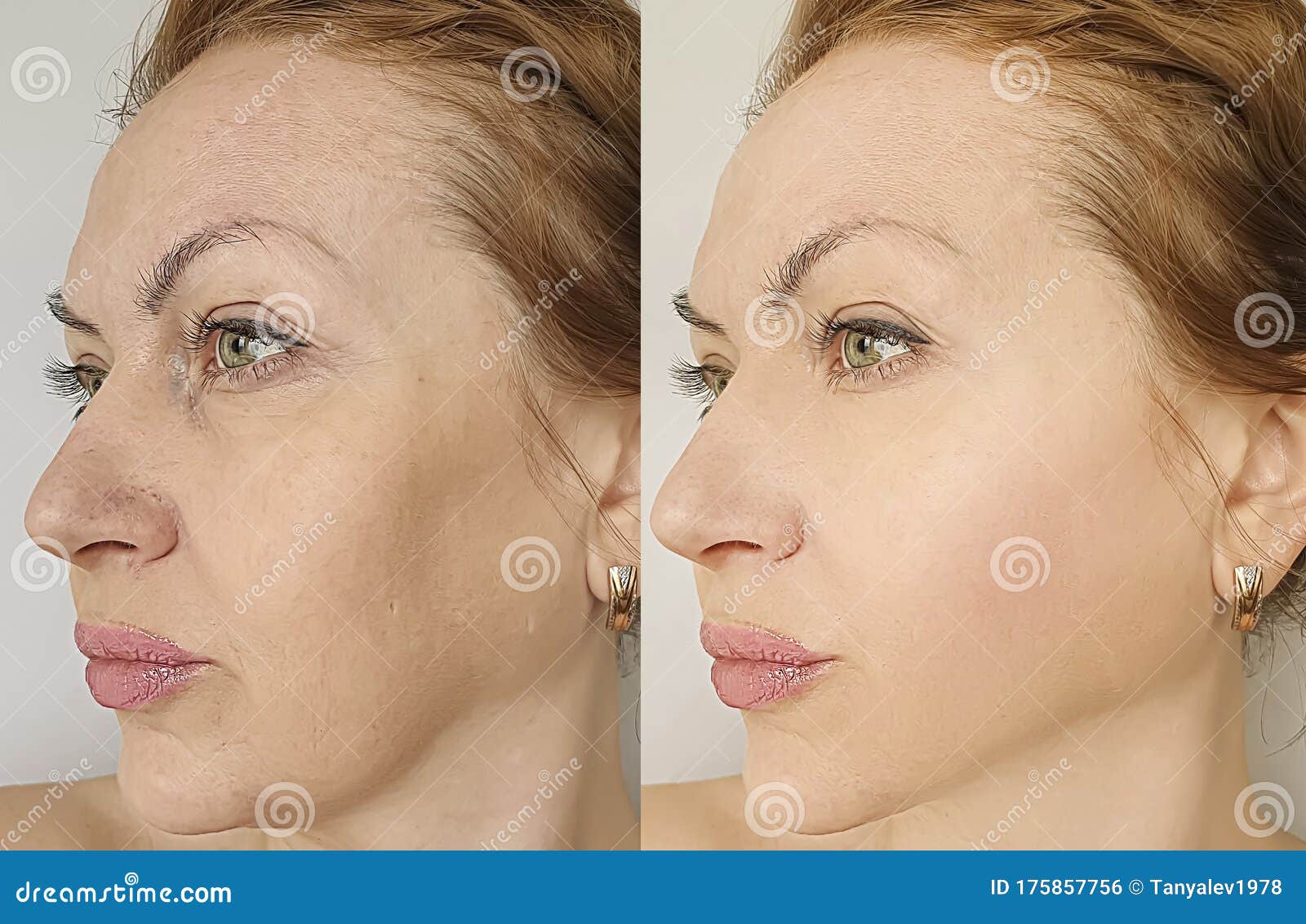 Woman Face Wrinkles before and after Treatment, Thread Lifting Stock ...