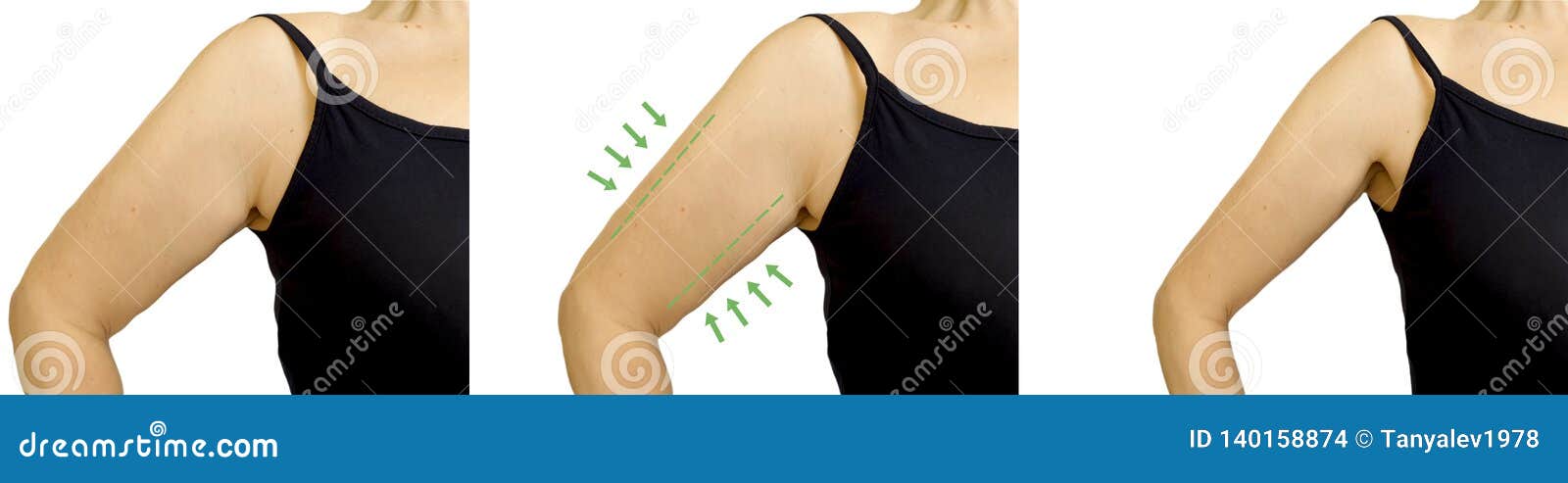 Woman Fat Hand before and after Stock Photo - Image of excess, hand ...