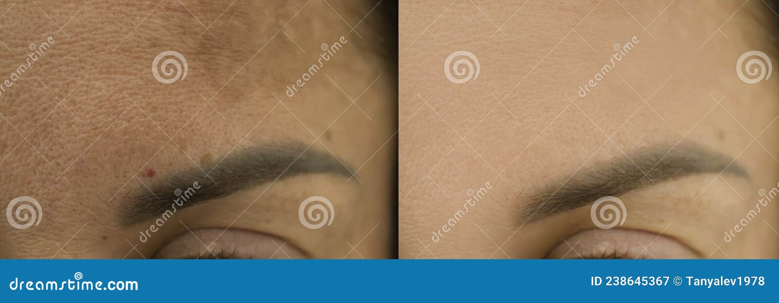 Woman Forehead Pigmentation before and after Treatmenproblem T Stock ...