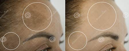 Woman Forehead Pigmentation before and after Treatment Stock Image ...