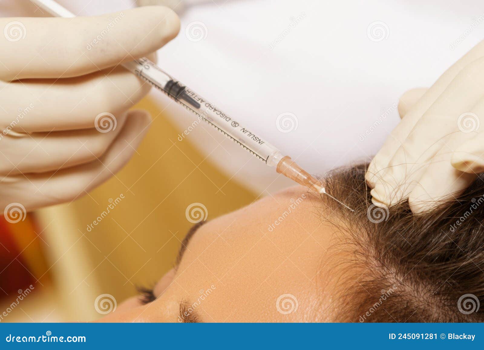 Woman Getting Special Injection for Hair Growth Stock Image - Image of ...