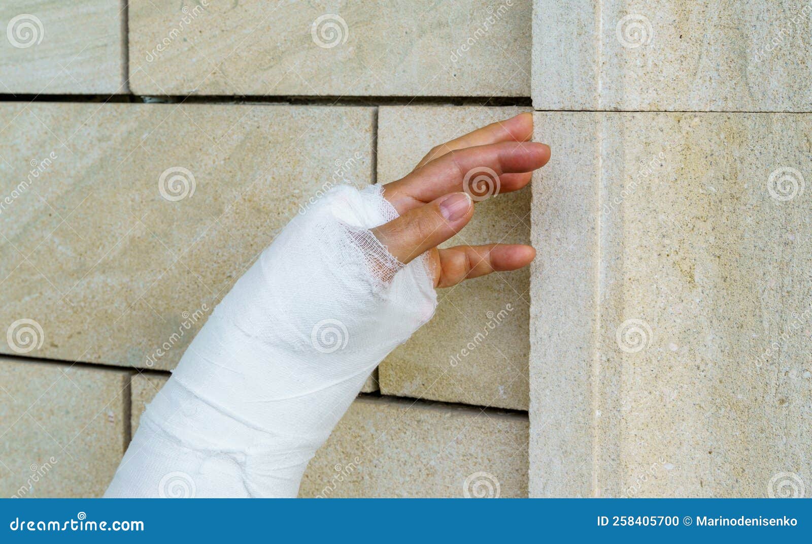 Woman Hand in White Plaster Cast Against the Backdrop of a Light Sandy ...