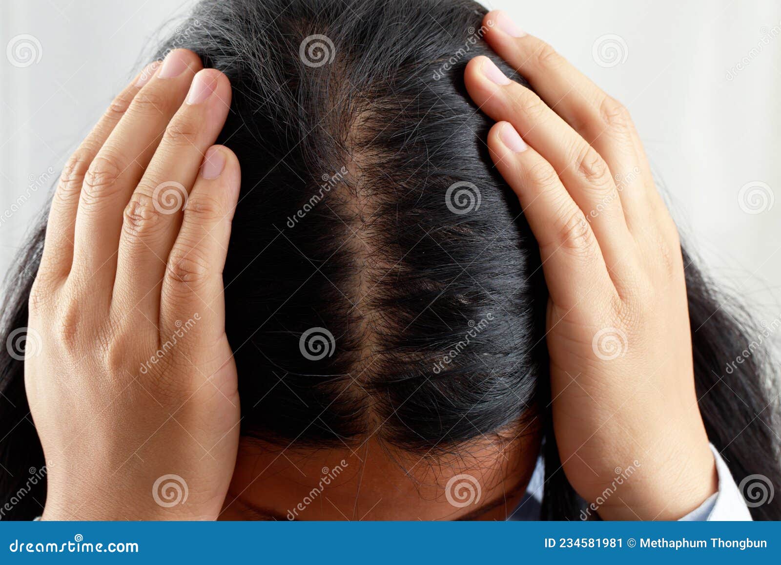 A Woman Has Problems with Hair and Scalp Stock Image - Image of health ...