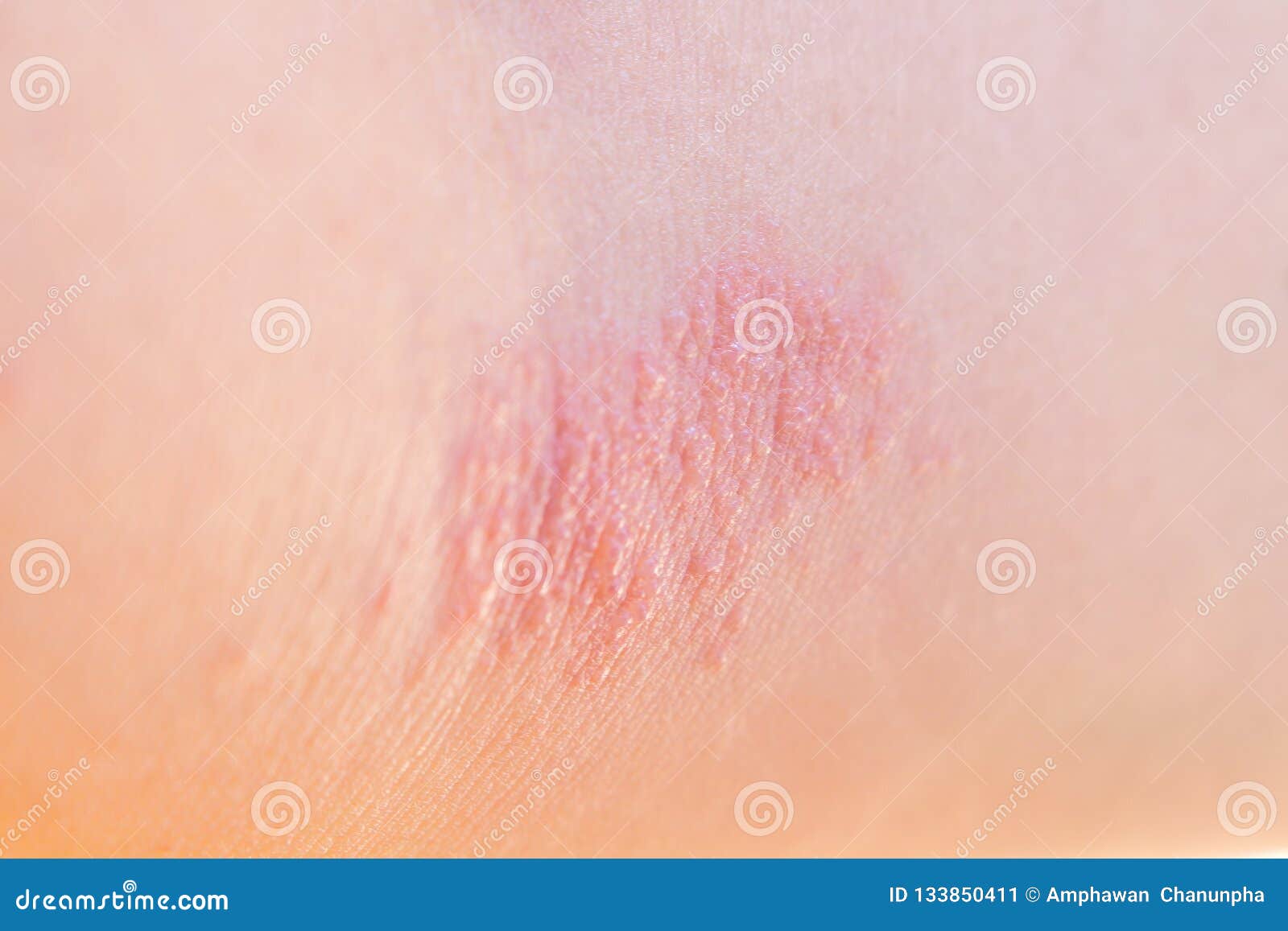 Woman has rash on her arm stock image. Image of care - 133850411
