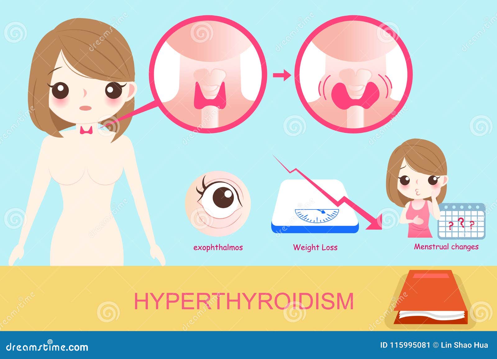 Diffuse And Nodular Goiter, The Thyroid Gland Is A Sectional View ...