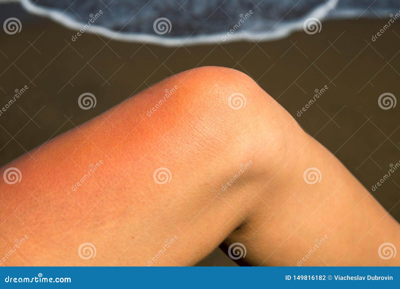 Woman Leg With Red Sunburn Skin On Seaside Background Sunburned Skin