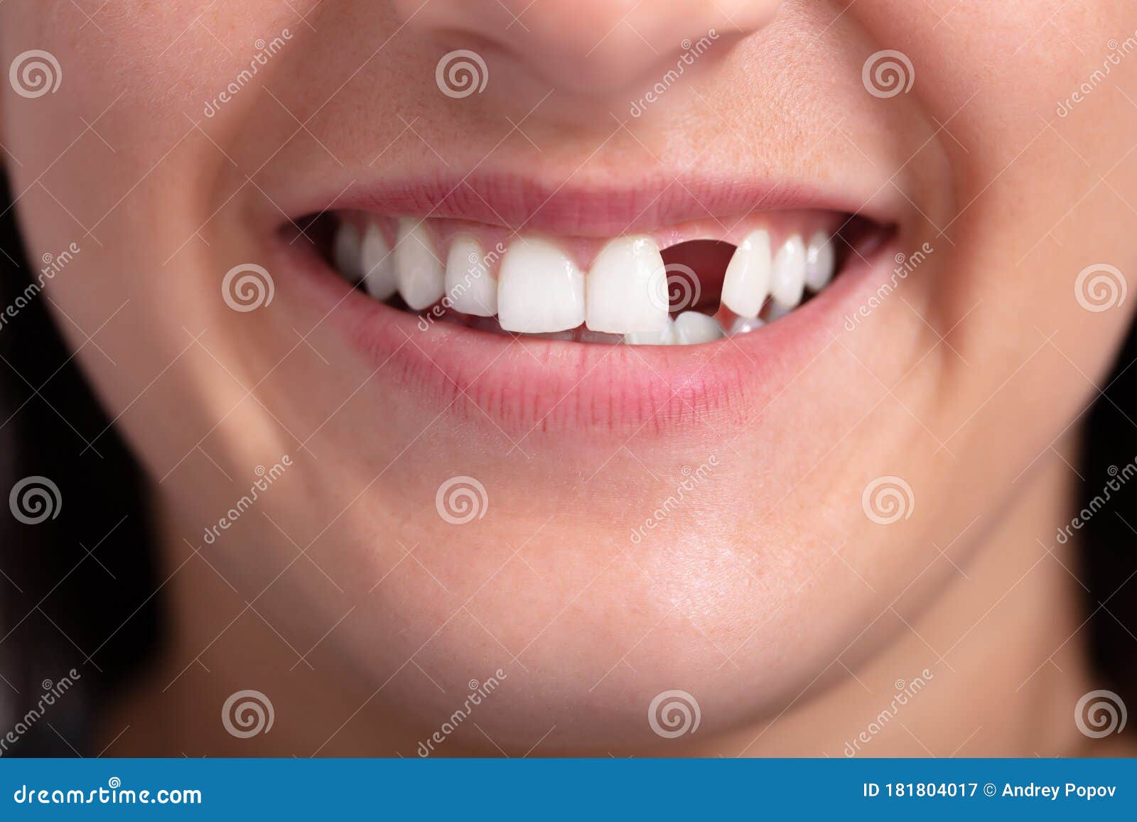 Woman with Missing Tooth stock image. Image of closeup - 181804017