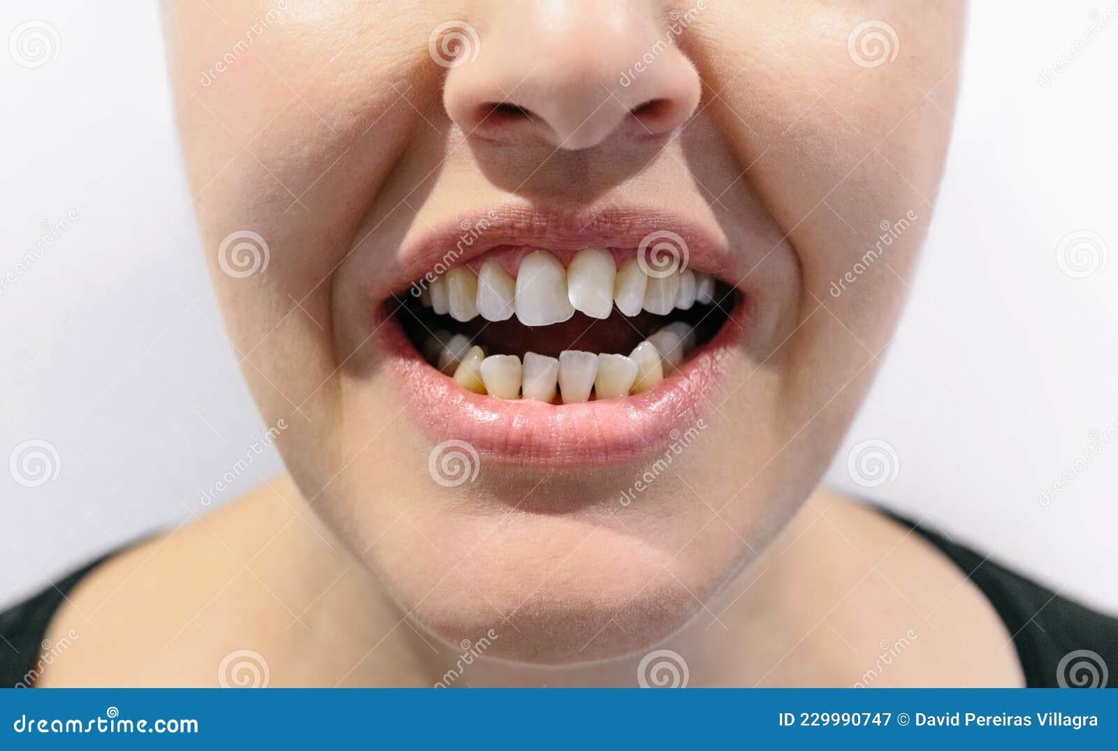 Crooked Teeth In The Anterior Part Of The Patient, At The Reception Of ...
