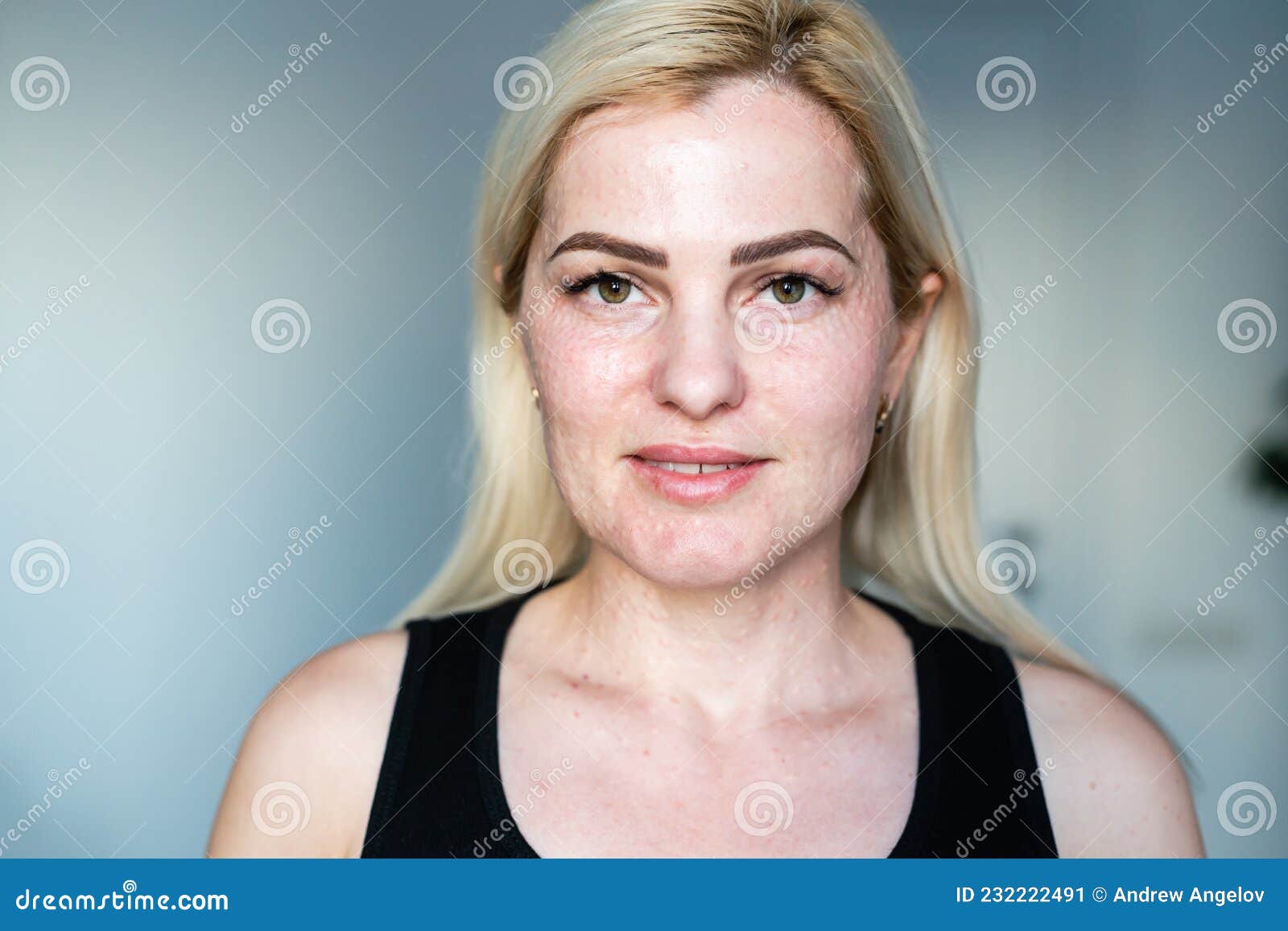 Woman Papules Face, Skin Texture Of Woman. Royalty-Free Stock Image ...