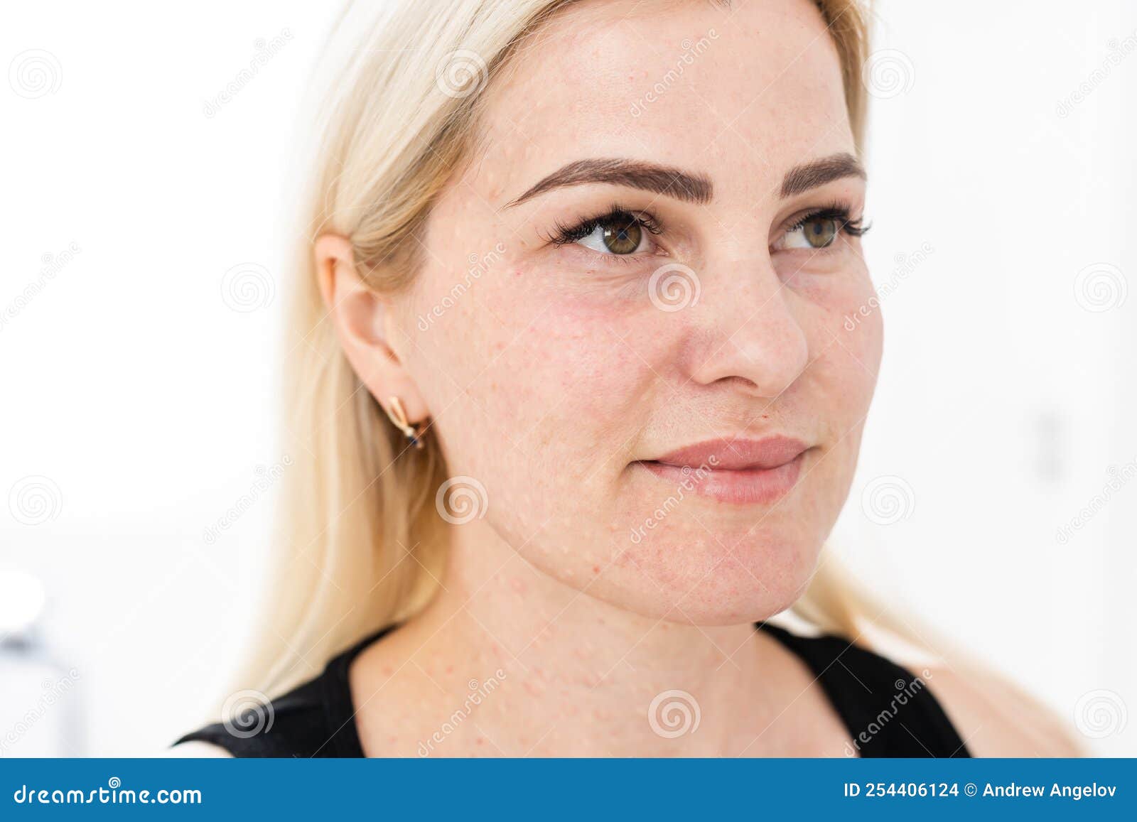 Woman Papules Face, Skin Texture of Woman. Stock Photo - Image of ...