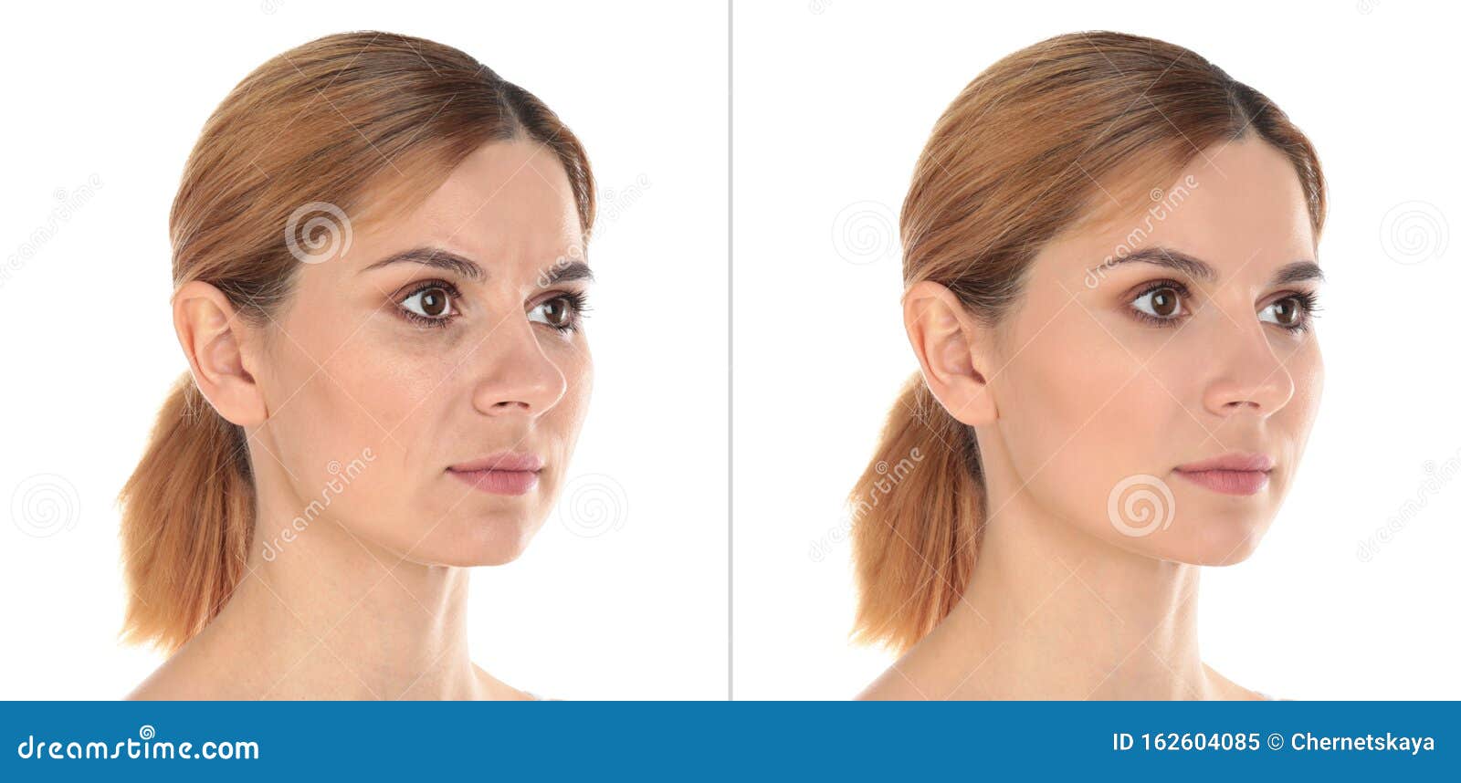 Woman Before And After Plastic Surgery On Background Royalty-Free Stock ...