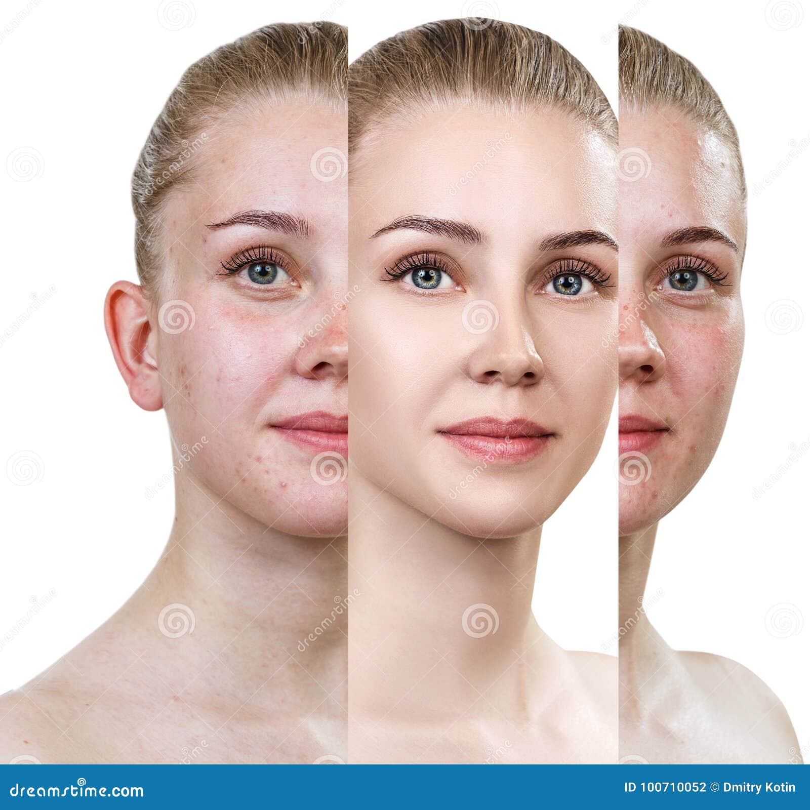 Woman with problem skin. stock photo. Image of complexion - 100710052