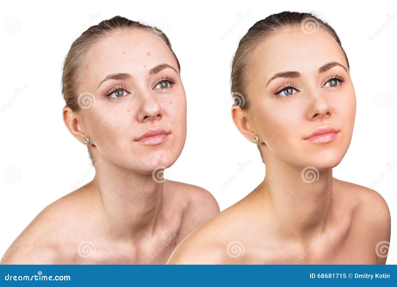 Woman with Problem Skin on Her Face Stock Image - Image of caucasian ...