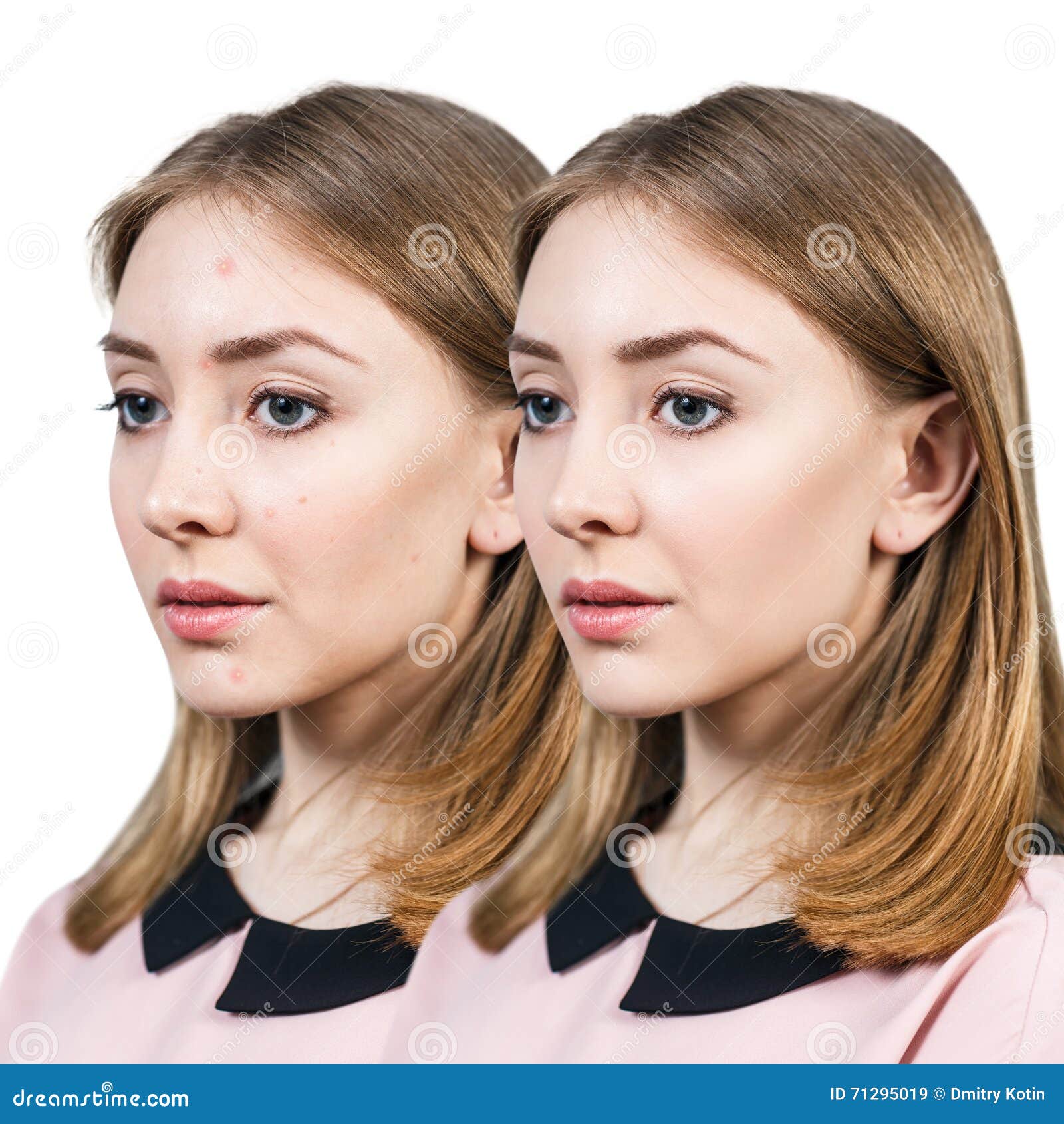 Woman with Problem Skin on Her Face Stock Image - Image of care, clean ...