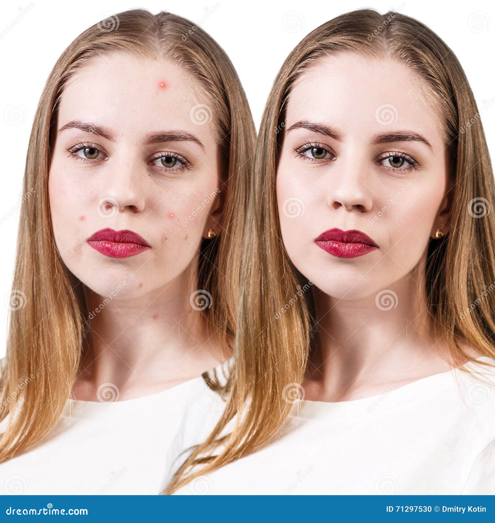 Woman with Problem Skin on Her Face Stock Photo - Image of health ...