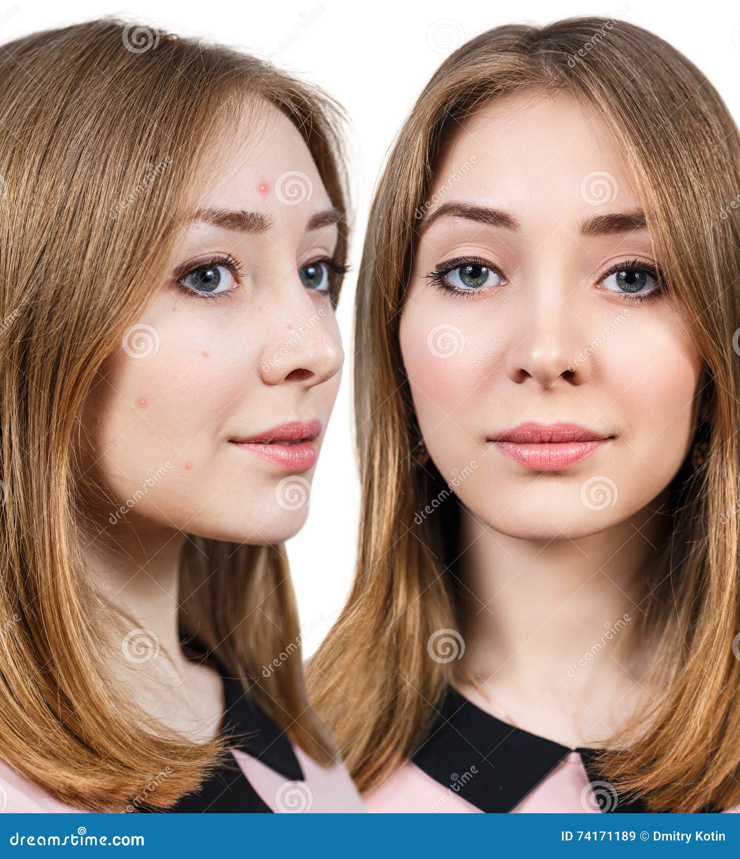 Woman with Problem Skin on Her Face Stock Image - Image of girl, makeup ...