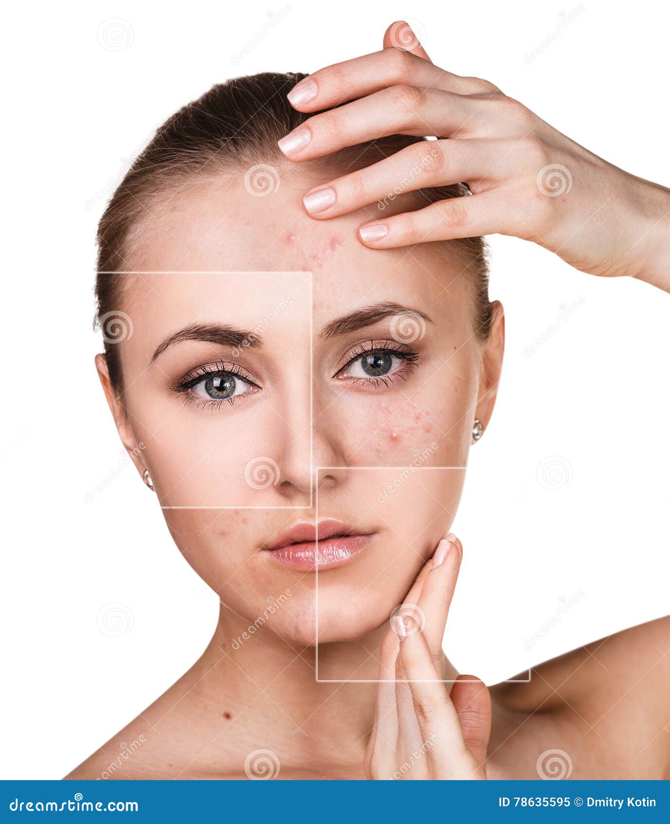 Woman with Problem Skin on Her Face Stock Image - Image of attractive ...
