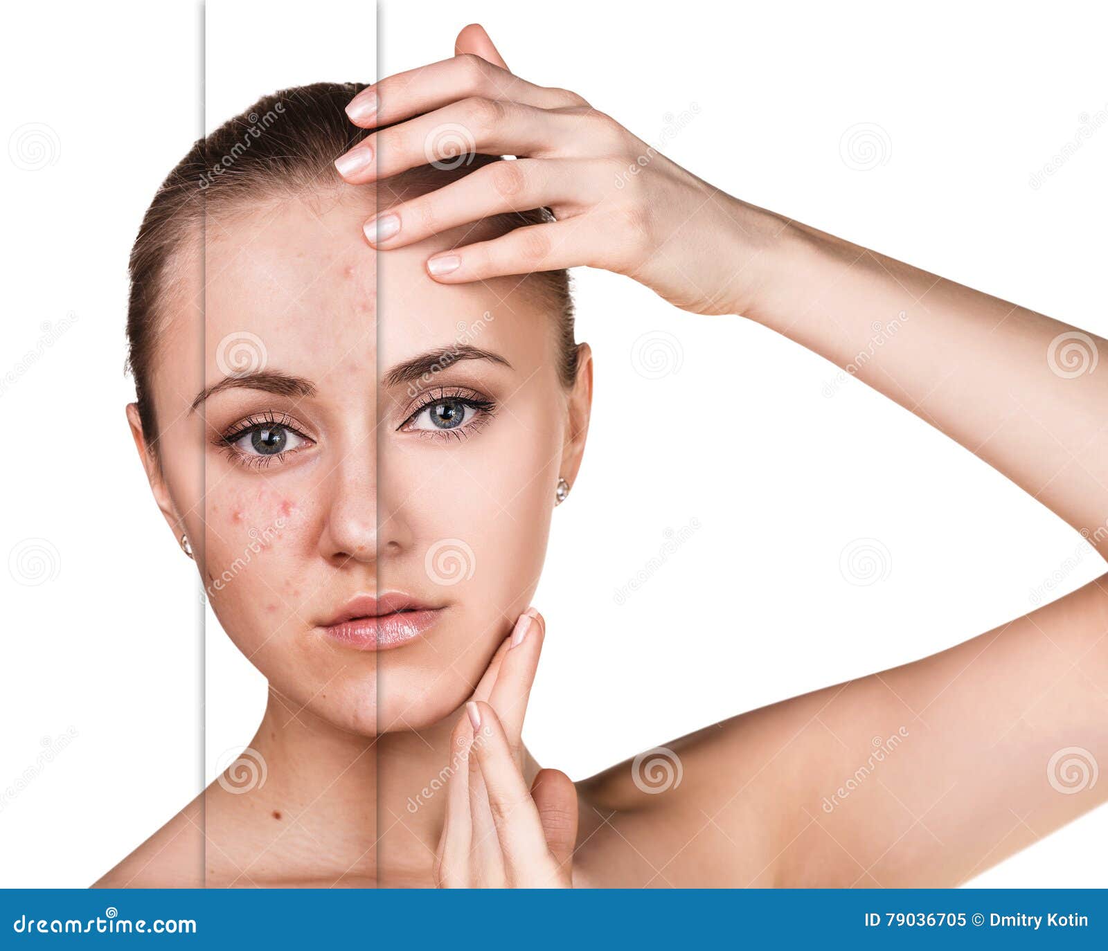 Woman with problem skin stock image. Image of acne, closeup - 79036705