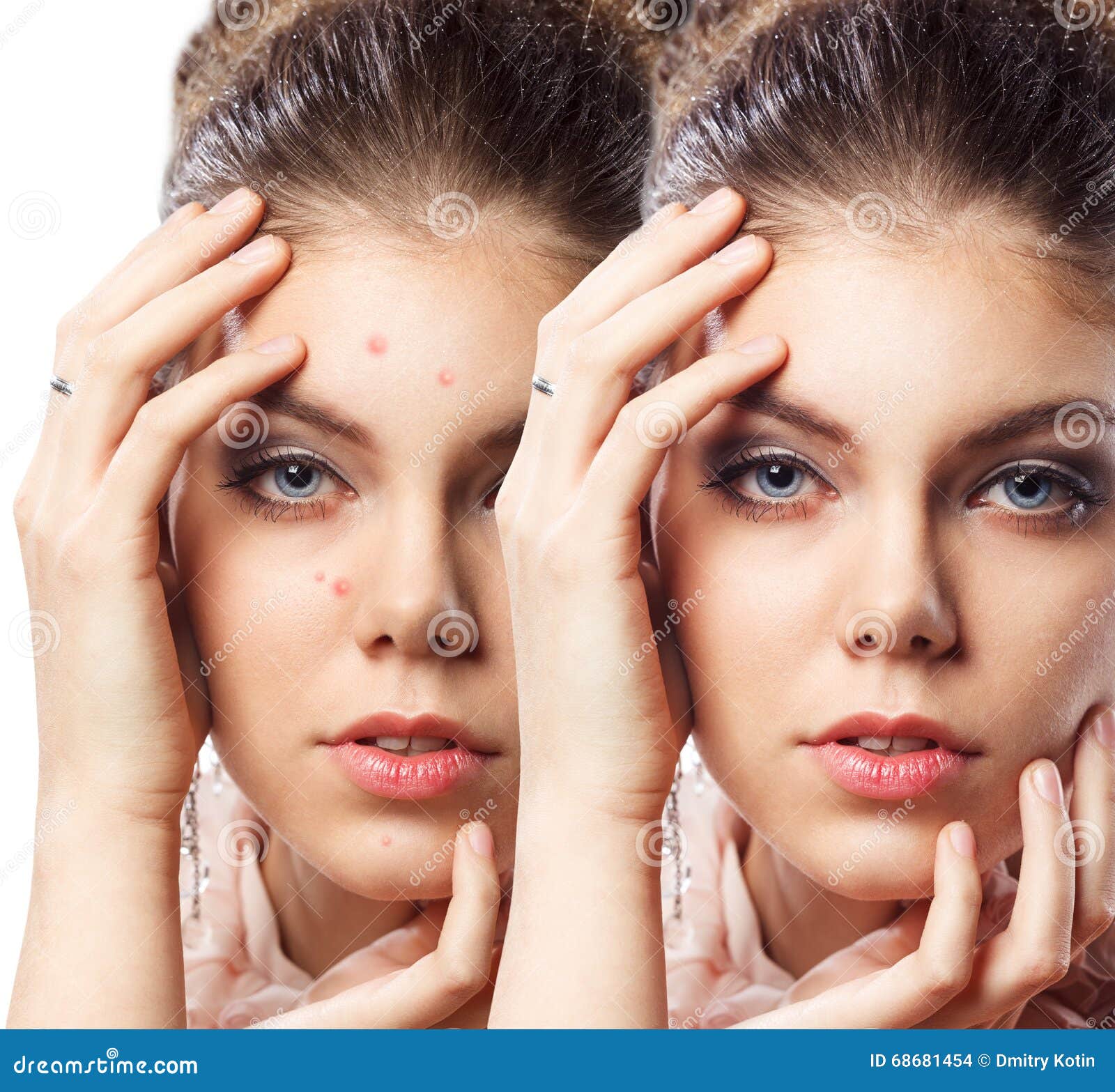 Woman with Problem Skin on Her Face Stock Photo - Image of complexion ...