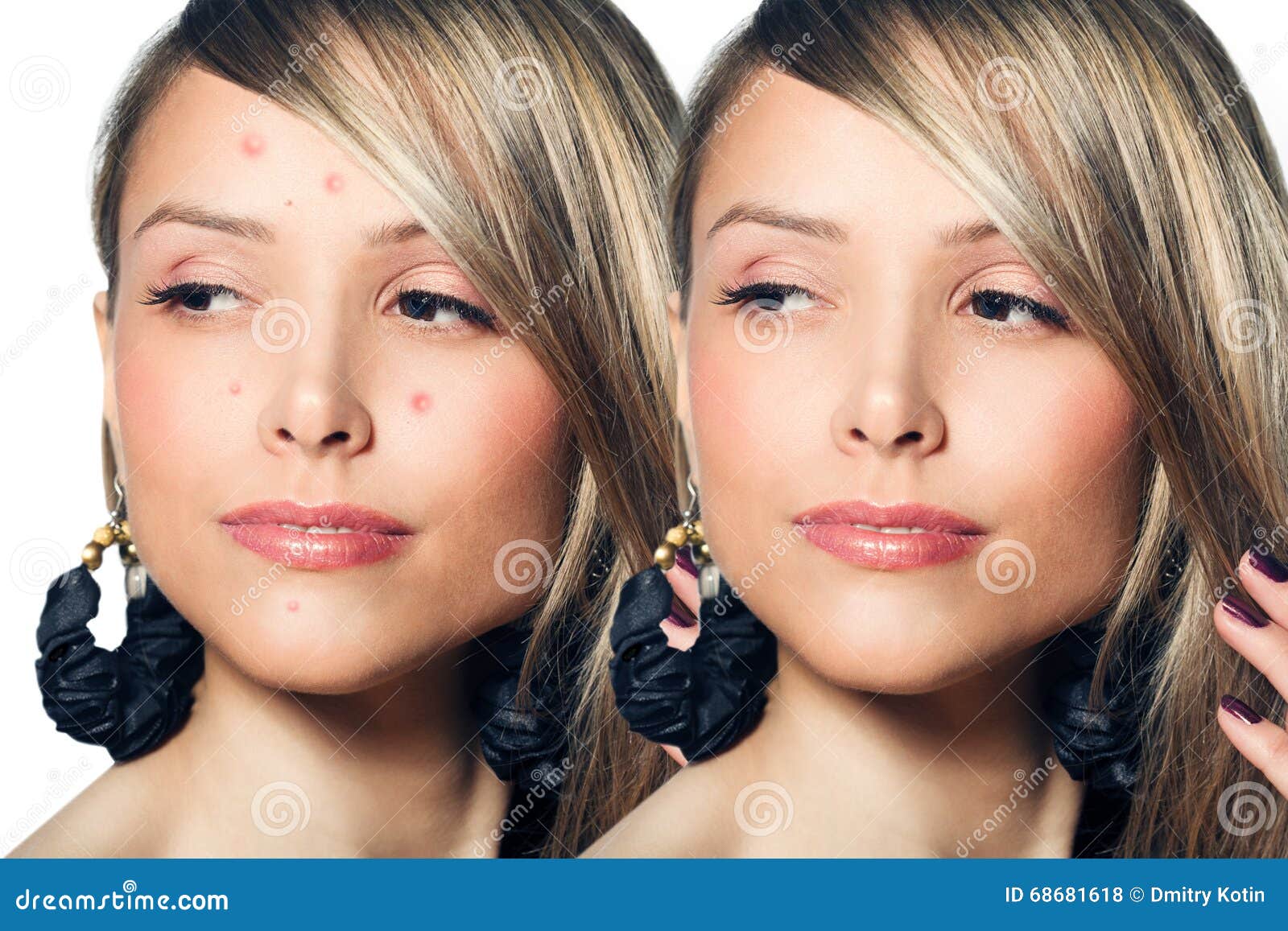 Woman with Problem Skin on Her Face Stock Photo - Image of face ...