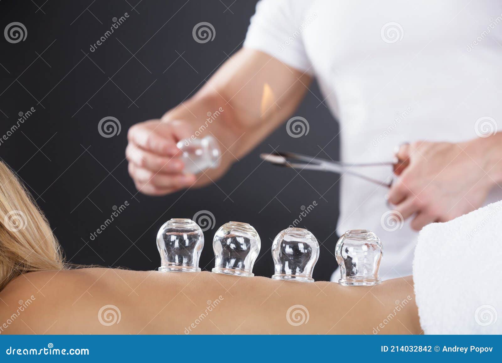 Woman Receiving Cupping Treatment on Back Stock Photo - Image of ...